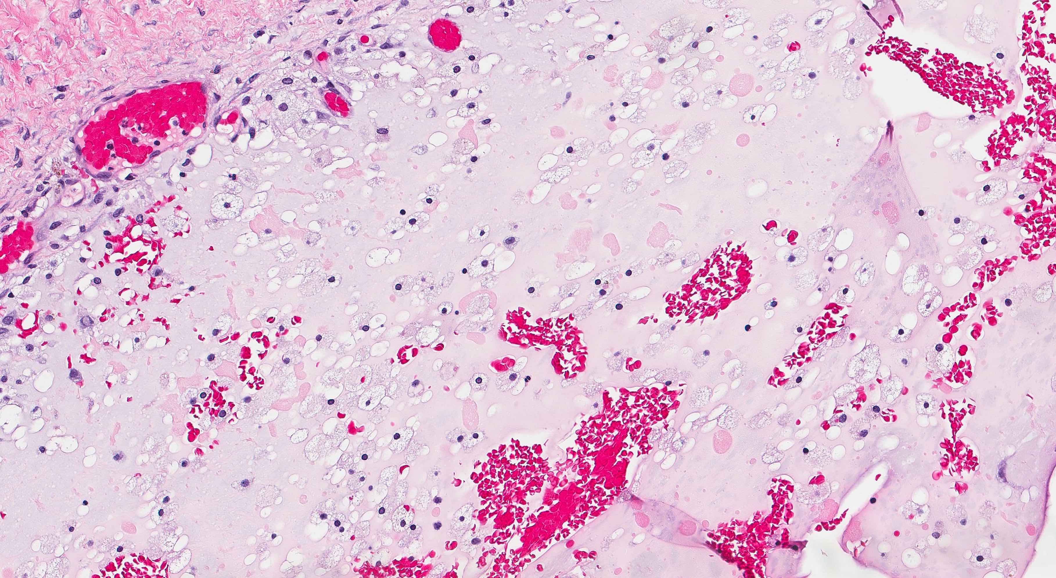 Pathology Outlines - Ranula