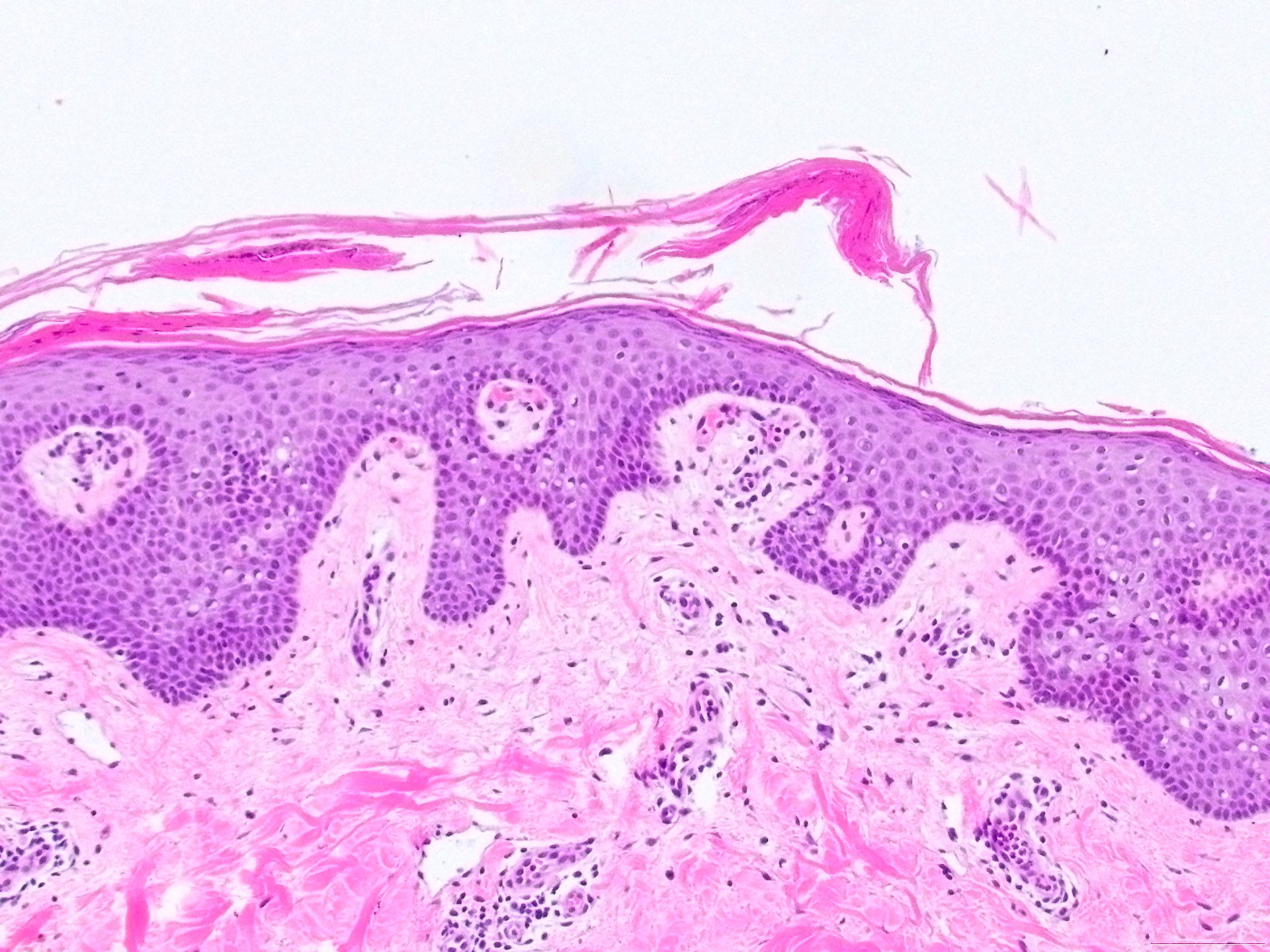 Pathology Outlines - Corynebacteria