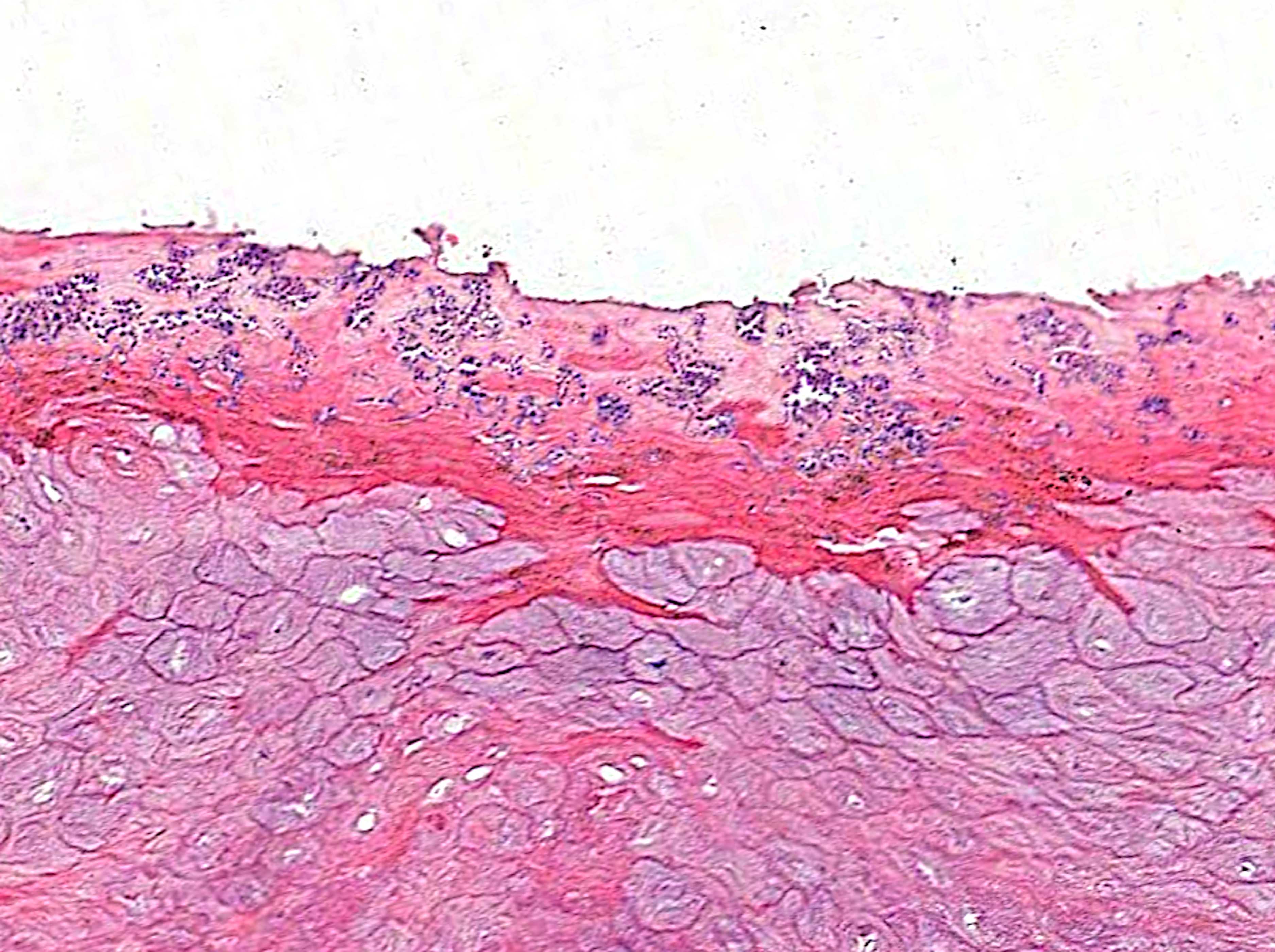 Cutaneous Erythrasma