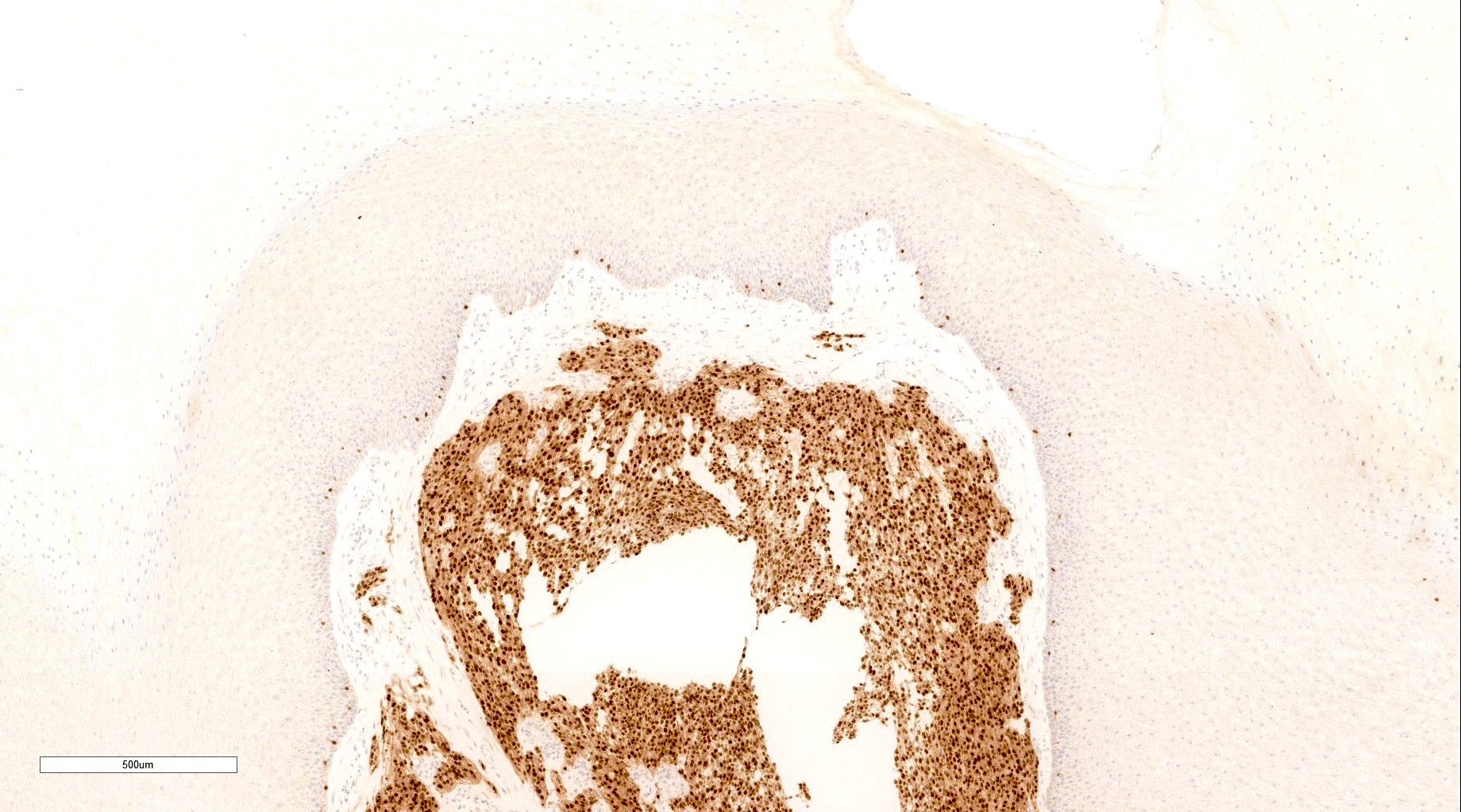 Pathology Outlines - CRTC1:TRIM11 cutaneous tumor