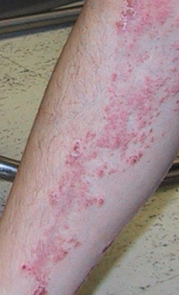 Pathology Outlines - Inflammatory linear verrucous epidermal nevus (ILVEN)