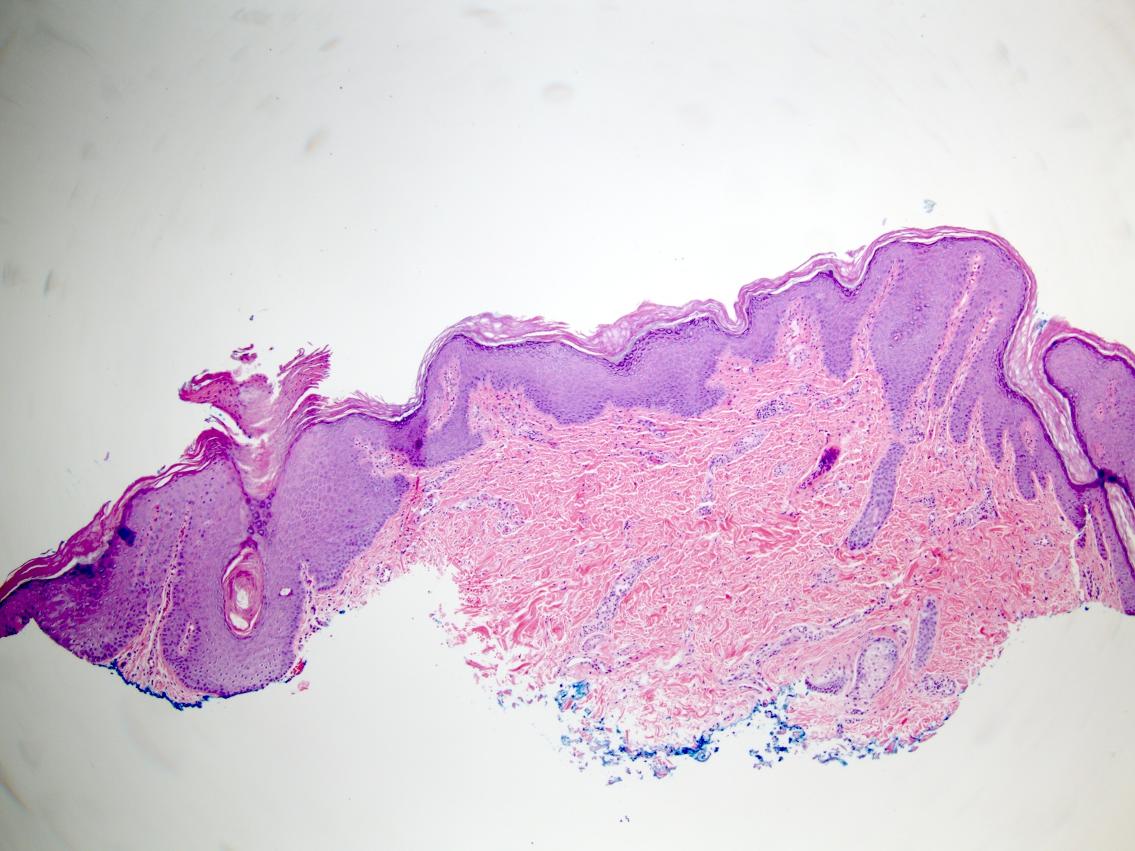 Pathology Outlines - Inflammatory linear verrucous epidermal nevus (ILVEN)