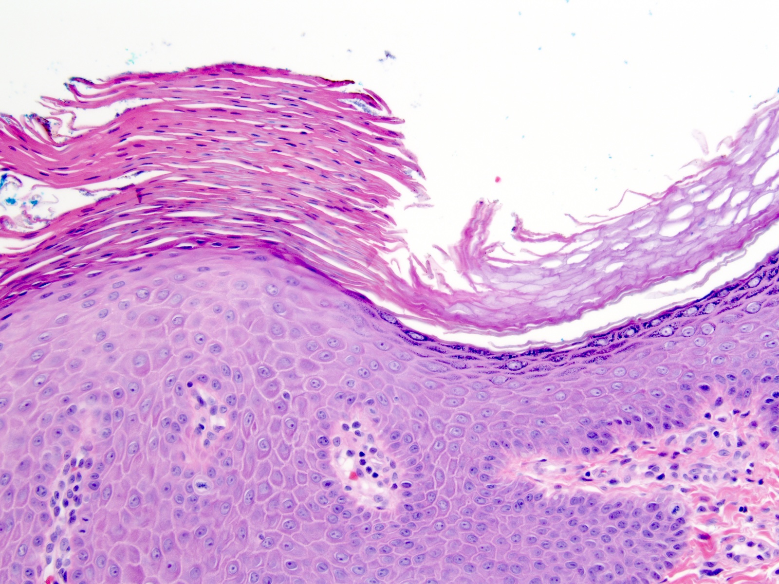 Pathology Outlines - Inflammatory linear verrucous epidermal nevus (ILVEN)