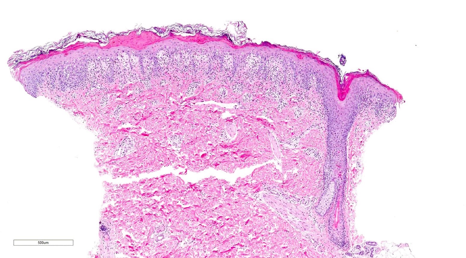 Pathology Outlines - Graft versus host disease