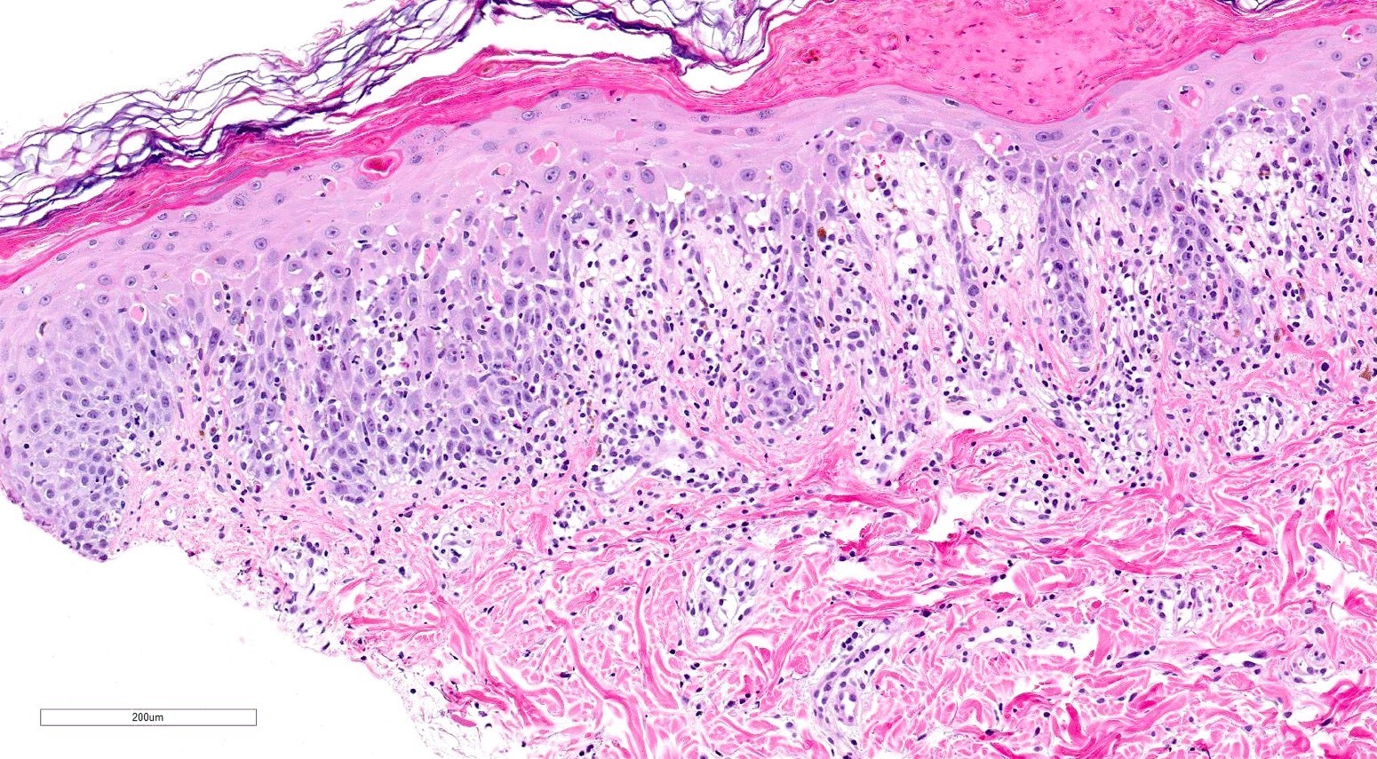 Pathology Outlines - Graft versus host disease