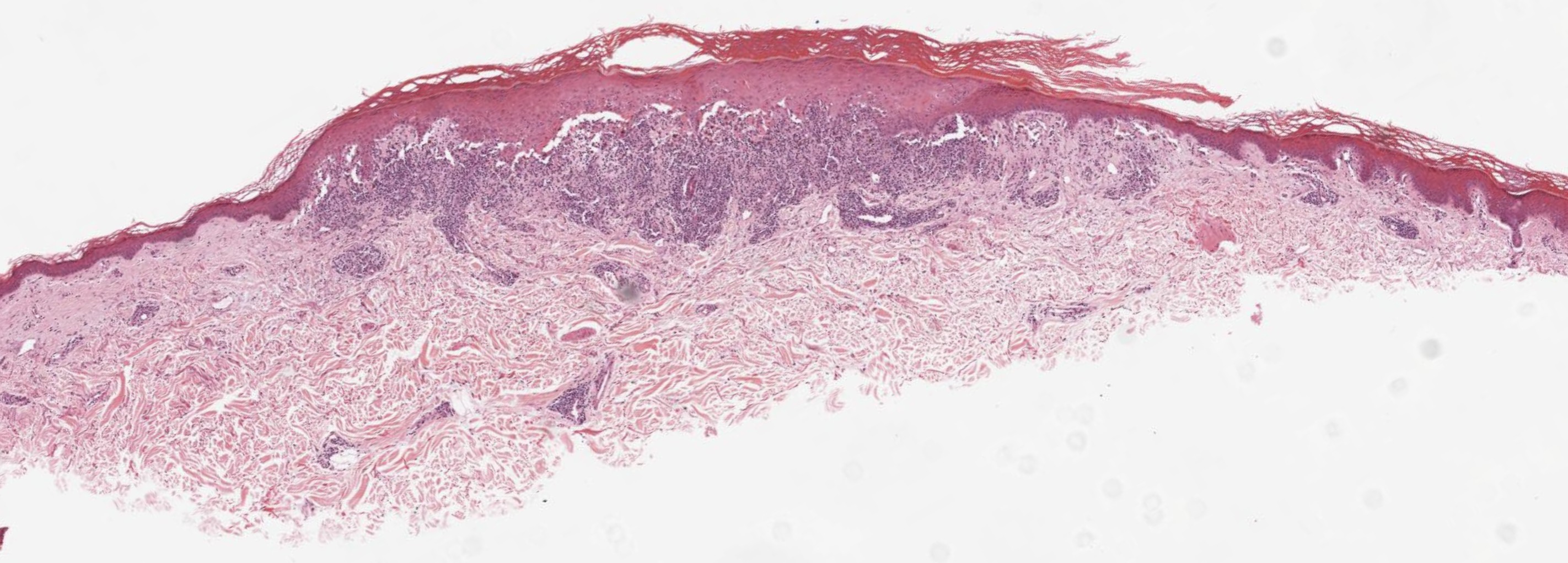 Pathology Outlines - Benign lichenoid keratosis