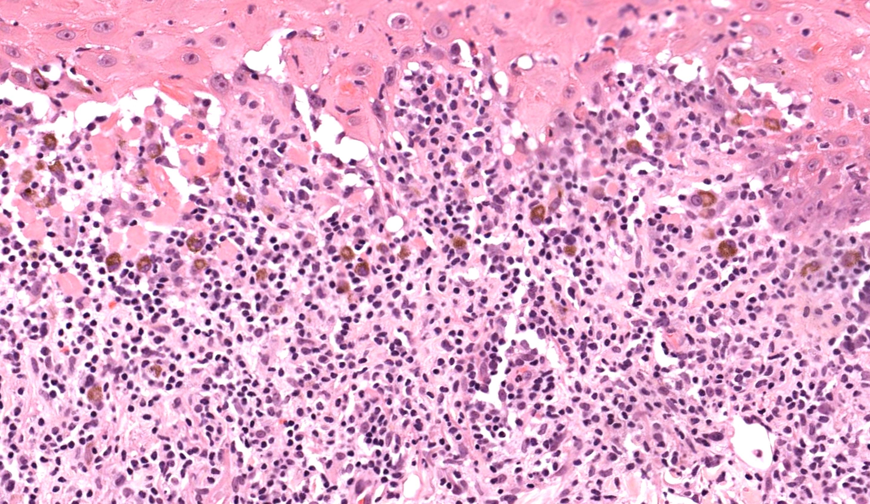 Pathology Outlines - Benign lichenoid keratosis