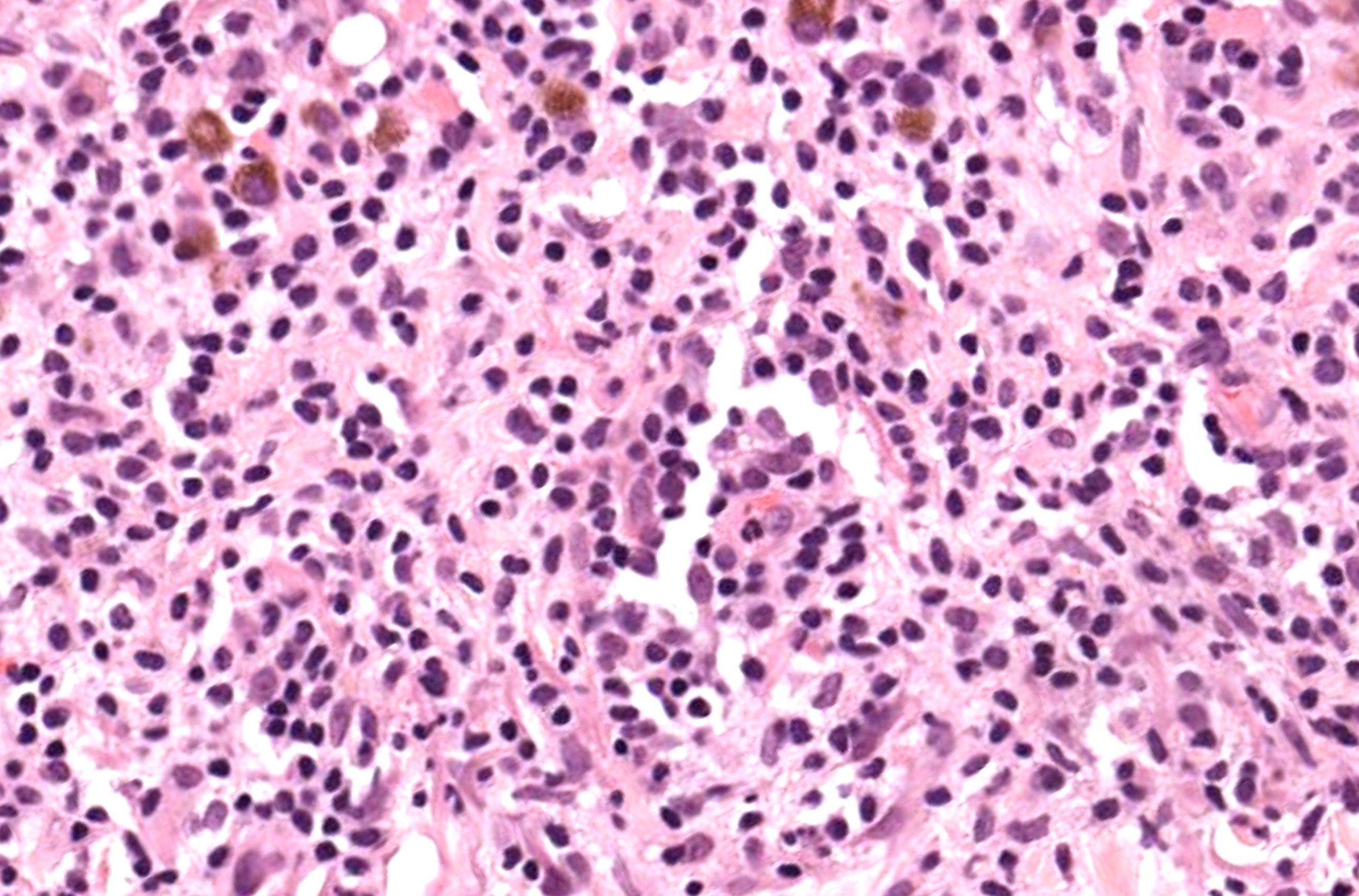 Pathology Outlines - Benign lichenoid keratosis
