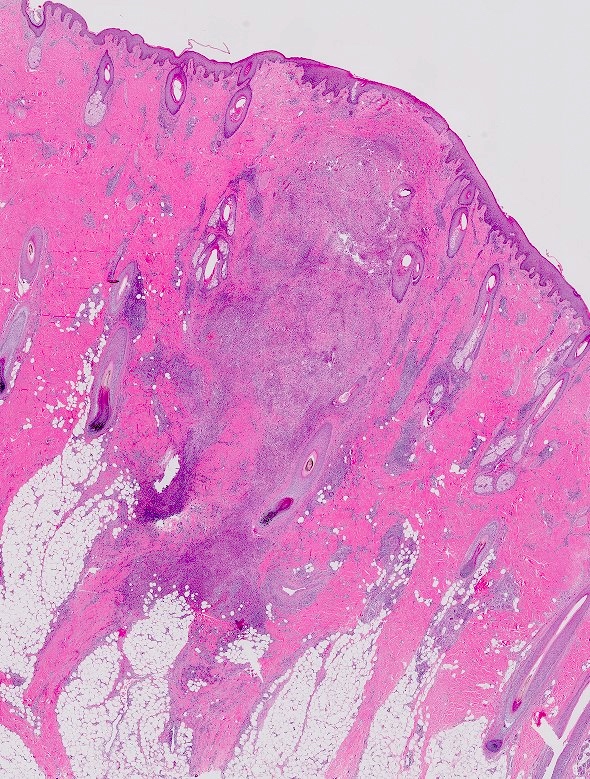 Pathology Outlines - Acne keloidalis
