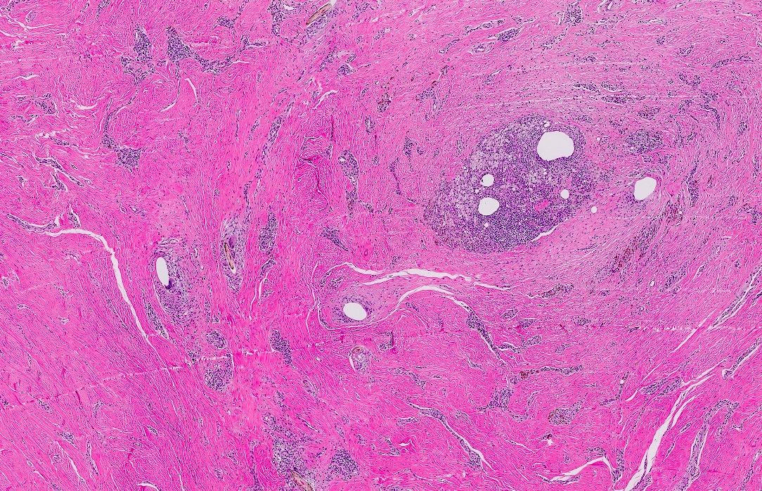 Pathology Outlines - Acne keloidalis