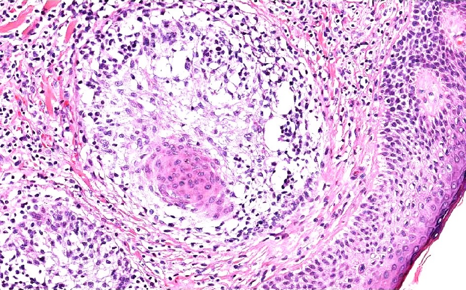 Histologia Da Mucinose Folicular Histología De La Piel Normal Y