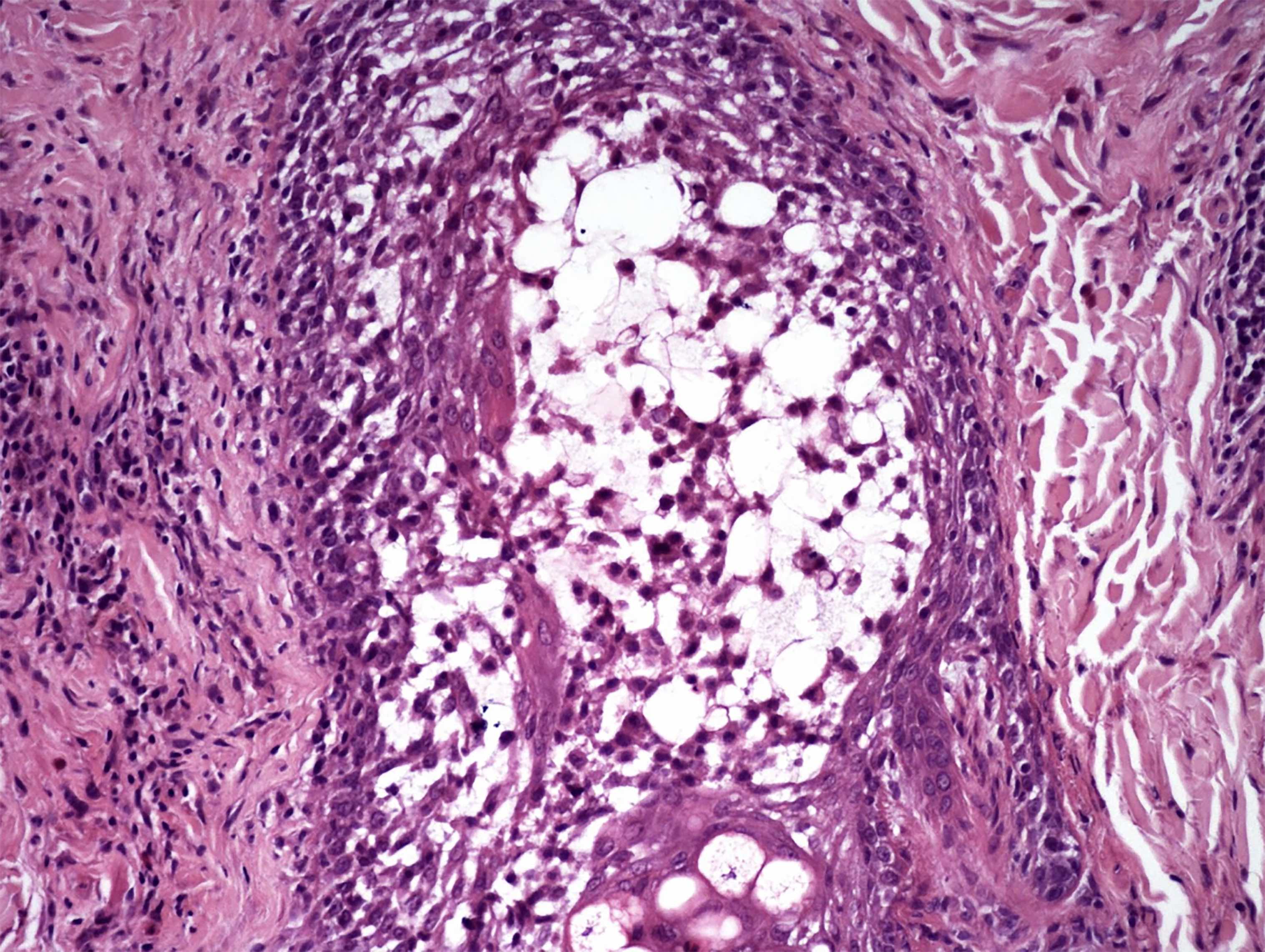 Pathology Outlines - Alopecia mucinosa