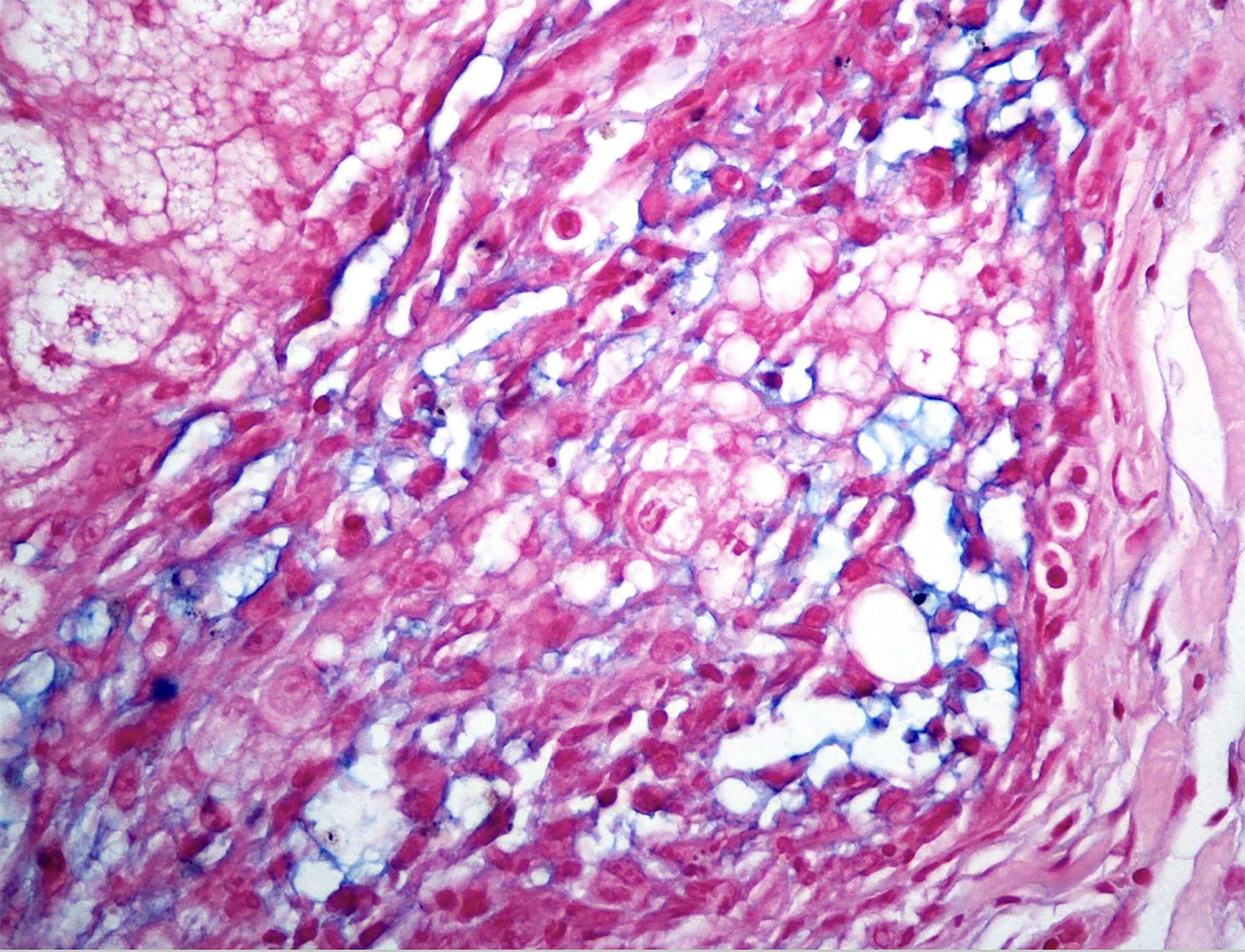 Pathology Outlines - Alopecia mucinosa