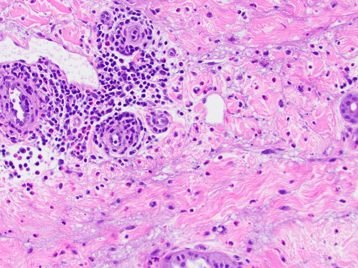 Pathology Outlines - Arthropod bites