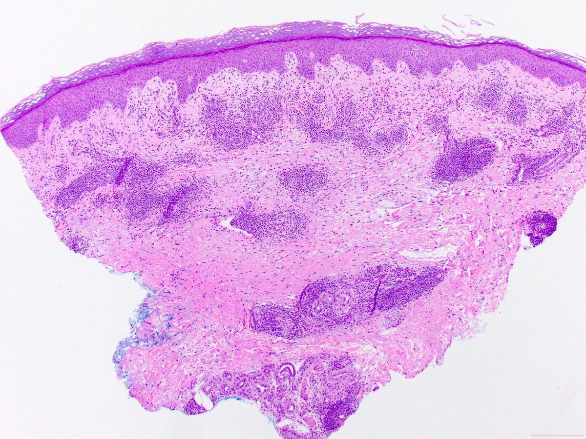 Pathology Outlines - Arthropod bites