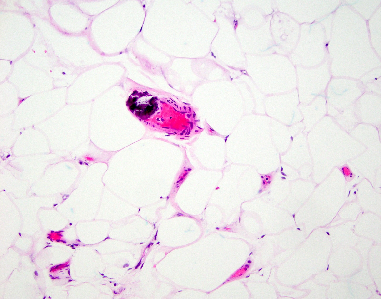 Pathology Outlines - Calciphylaxis