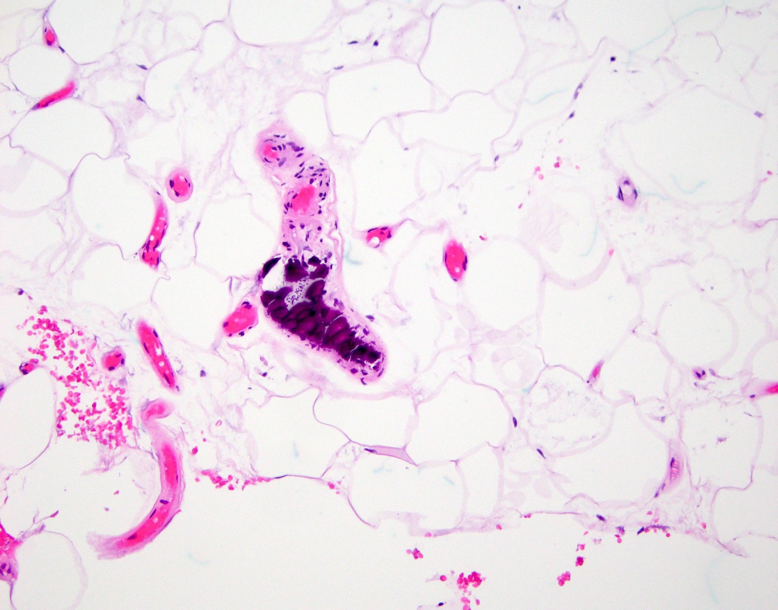 Pathology Outlines - Calciphylaxis