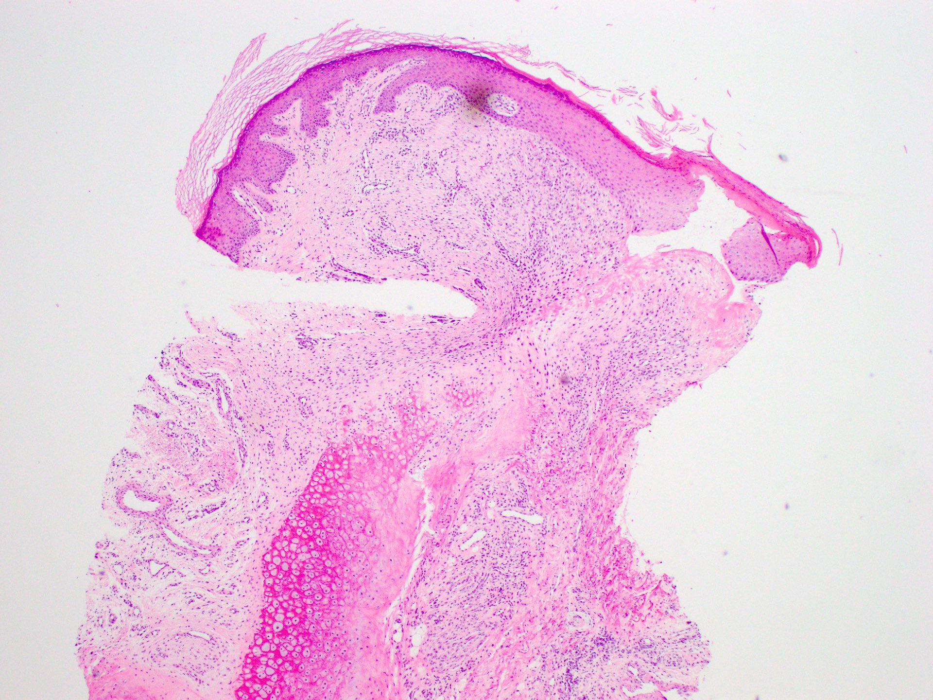 Pathology Outlines - Chondrodermatitis nodularis helicis