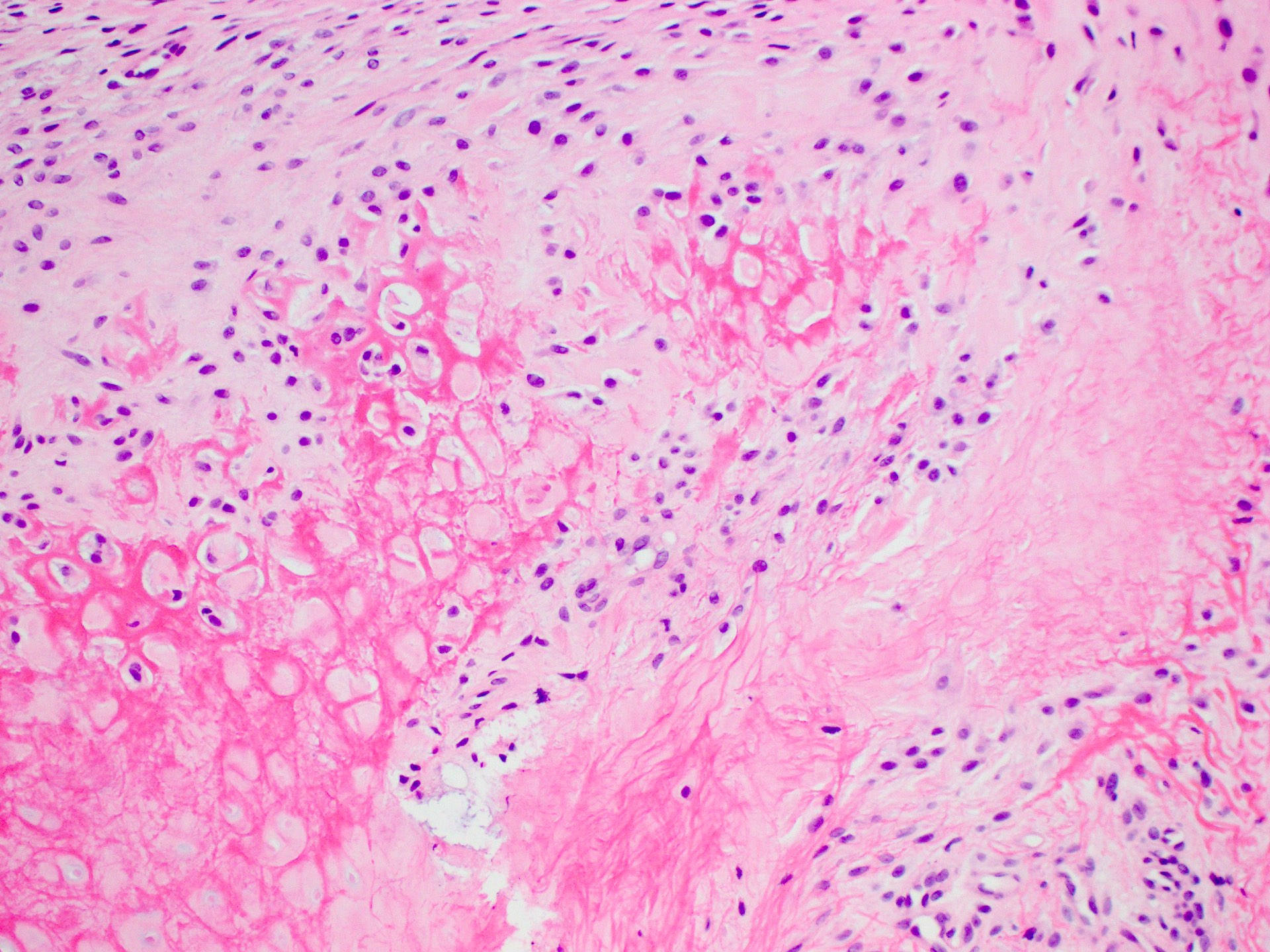 Pathology Outlines - Chondrodermatitis nodularis helicis