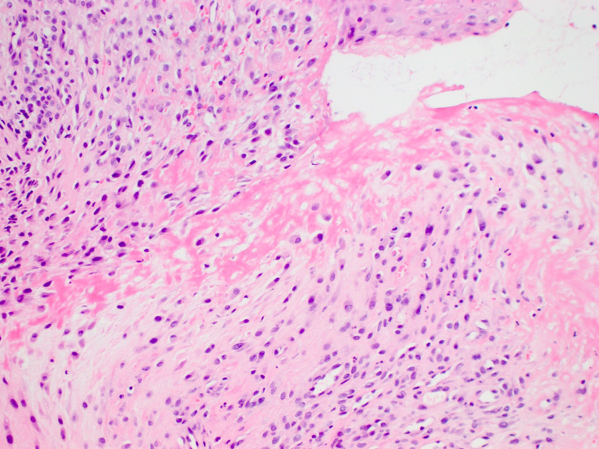Pathology Outlines - Chondrodermatitis nodularis helicis