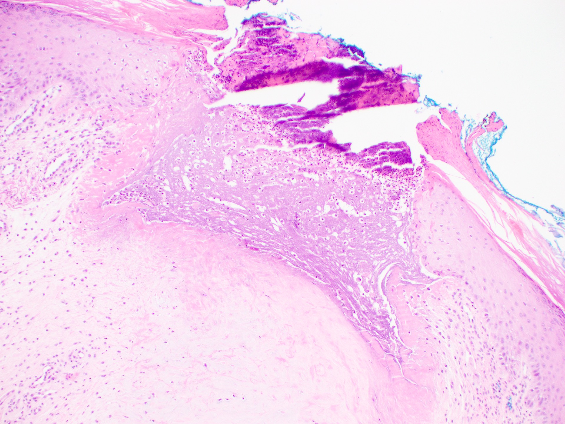 Pathology Outlines - Chondrodermatitis nodularis helicis