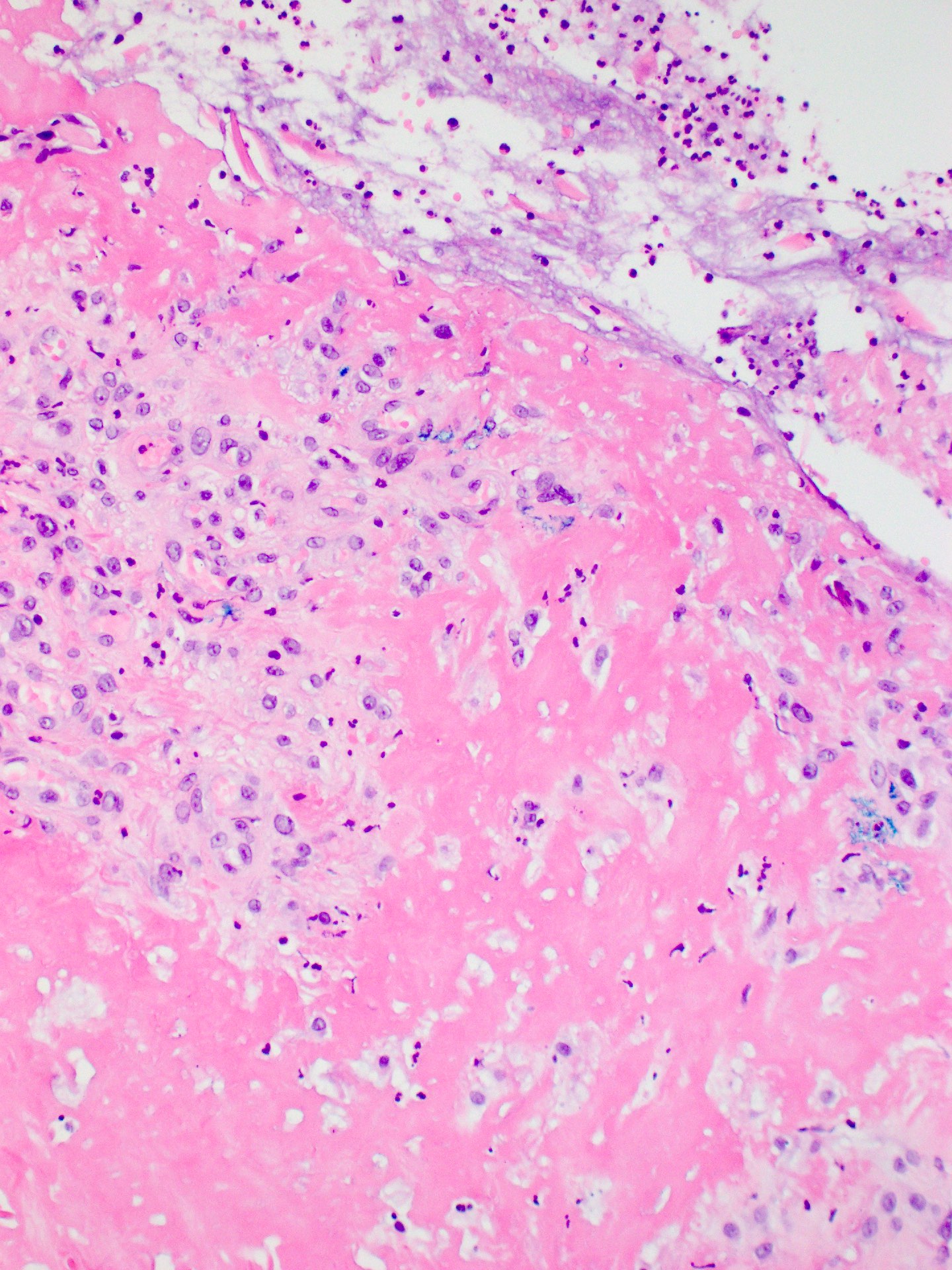 Pathology Outlines - Chondrodermatitis nodularis helicis
