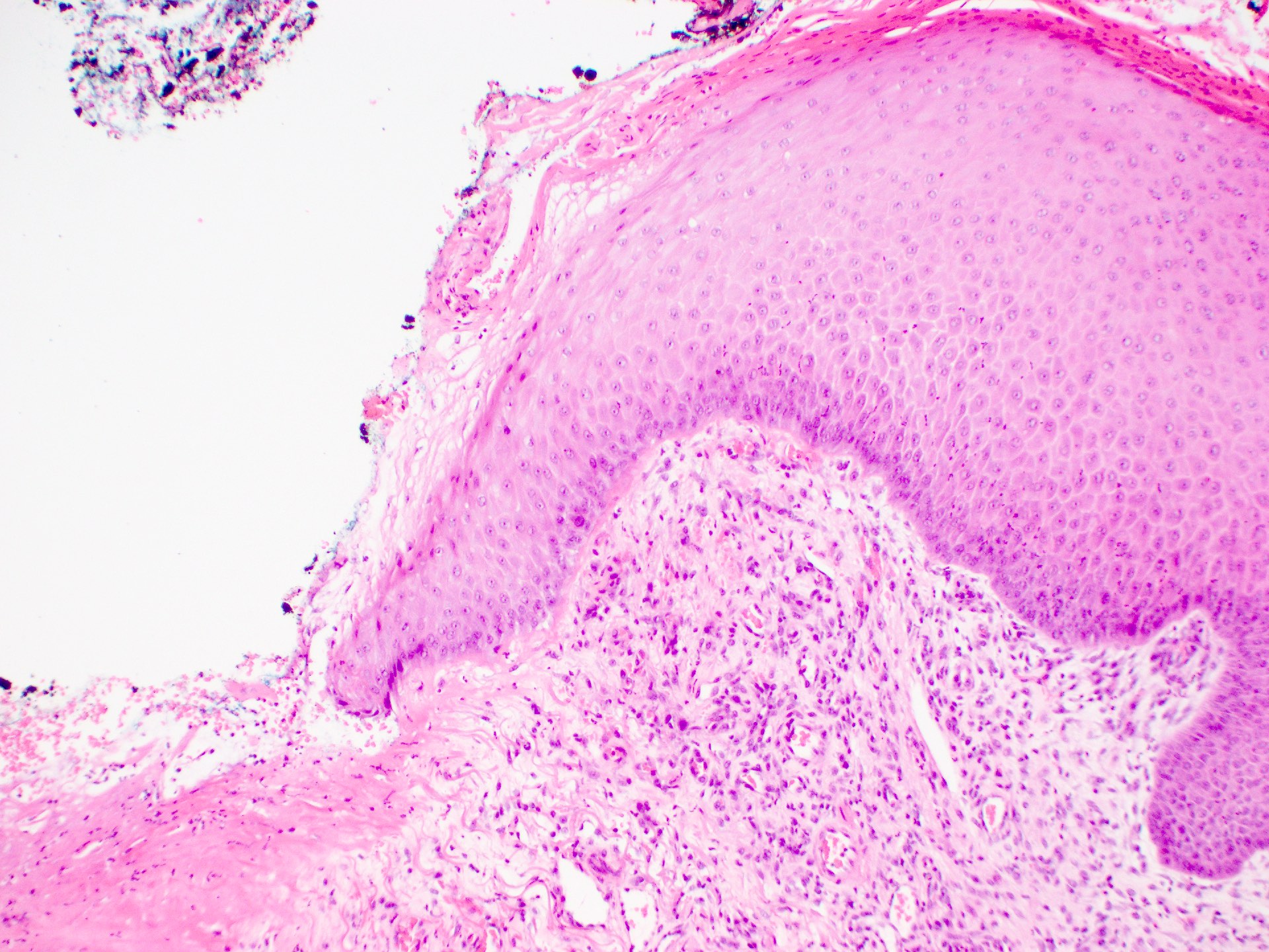 Pathology Outlines - Chondrodermatitis nodularis helicis