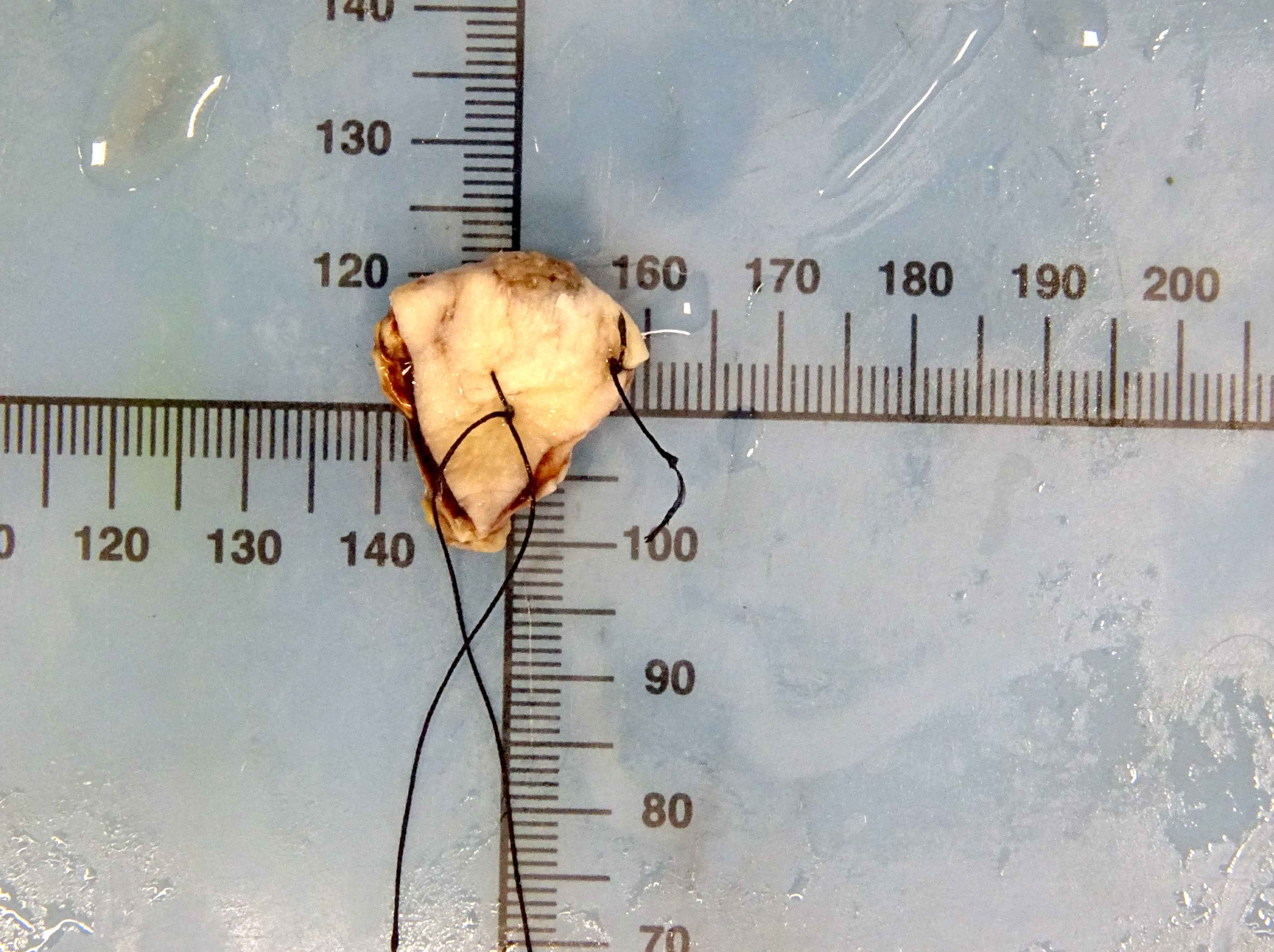 Pathology Outlines - Chondrodermatitis nodularis helicis