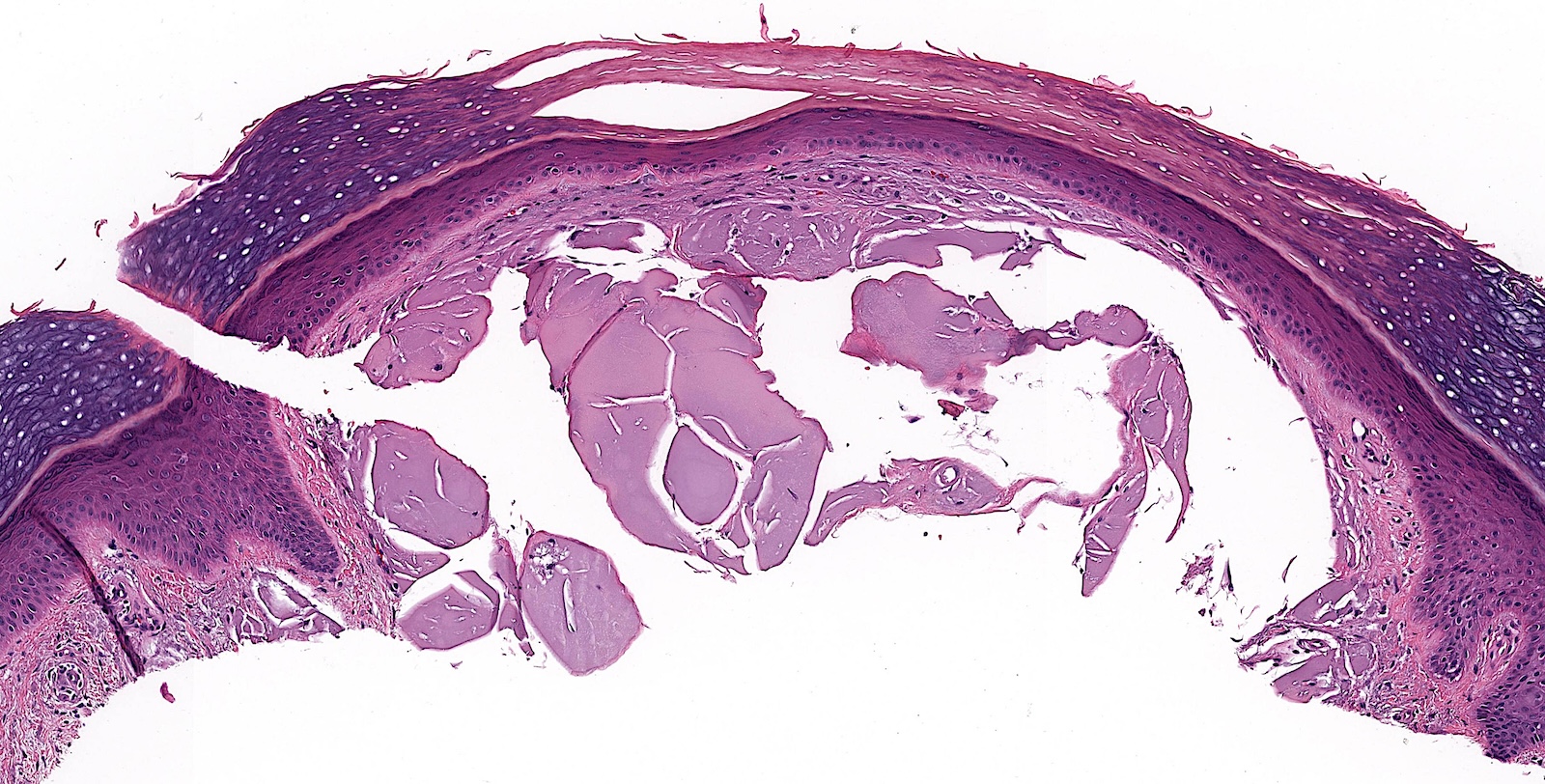 Pathology Outlines - Colloid milium