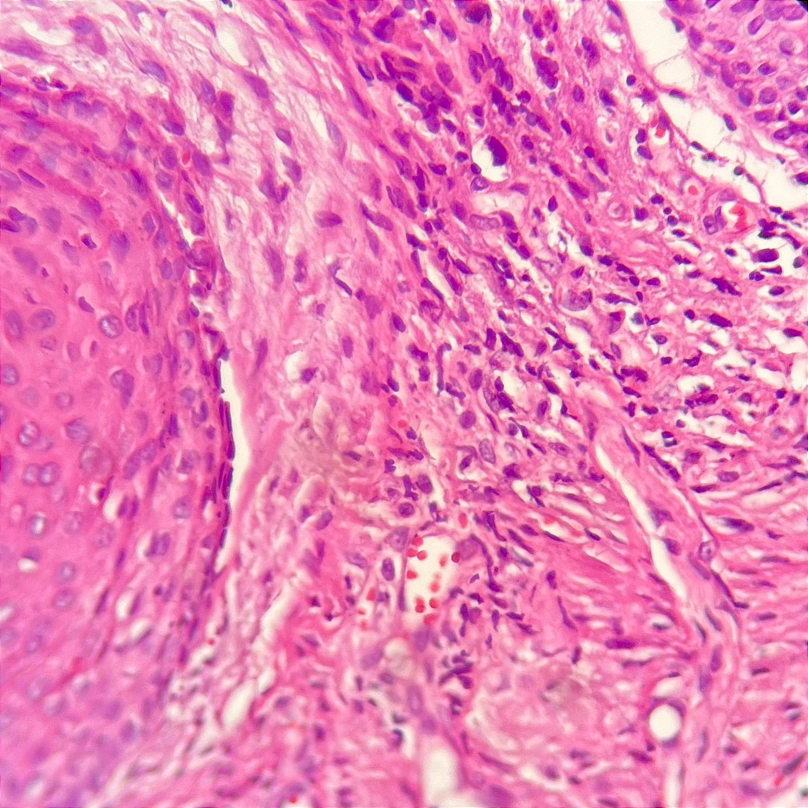 Pathology Outlines - Dissecting cellulitis