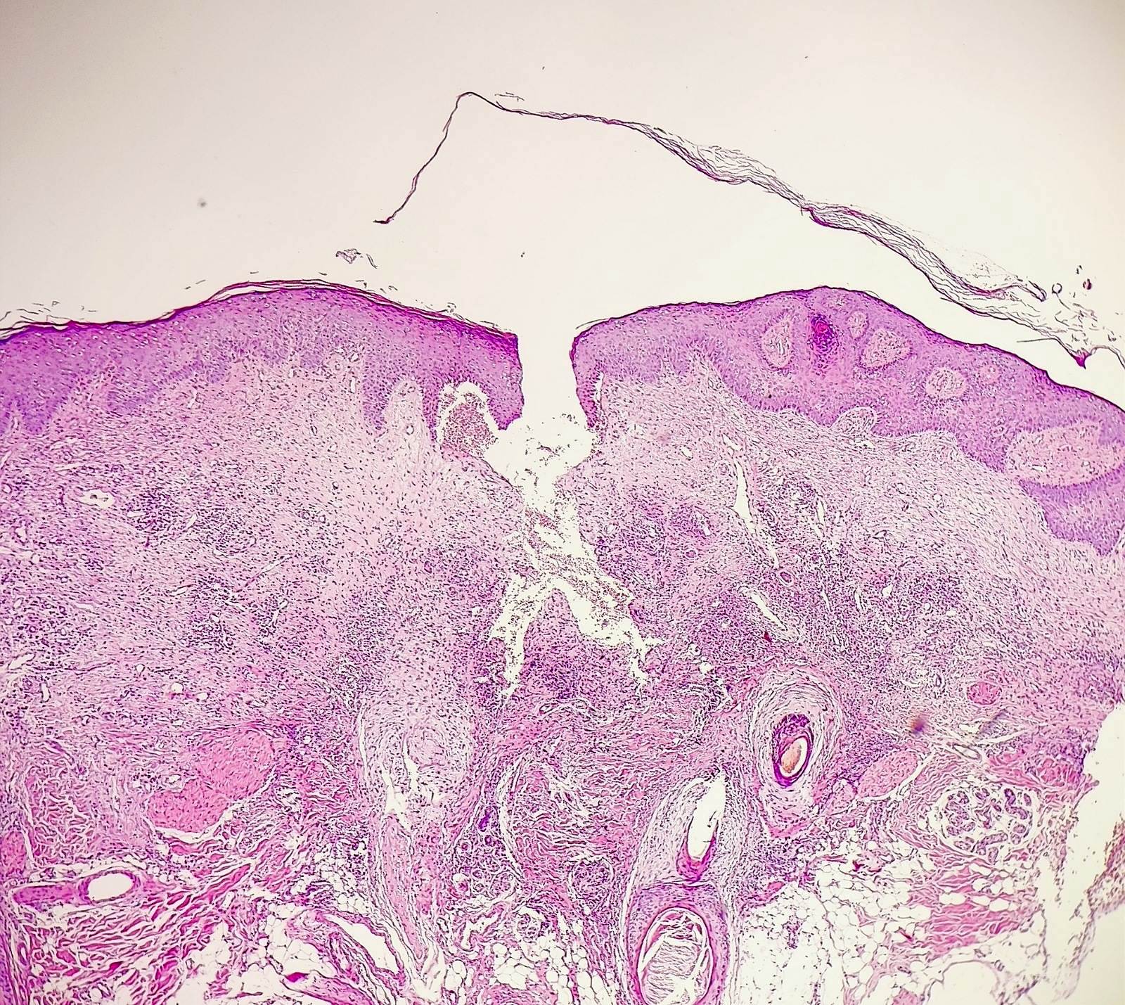 Pathology Outlines - Dissecting cellulitis