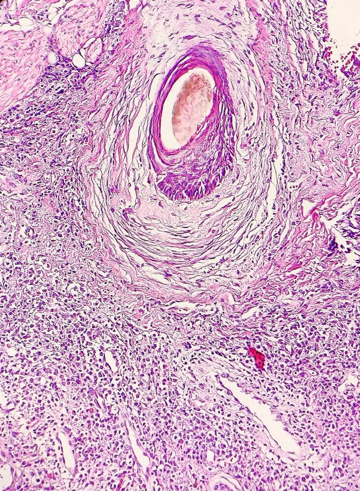 Pathology Outlines - Dissecting cellulitis