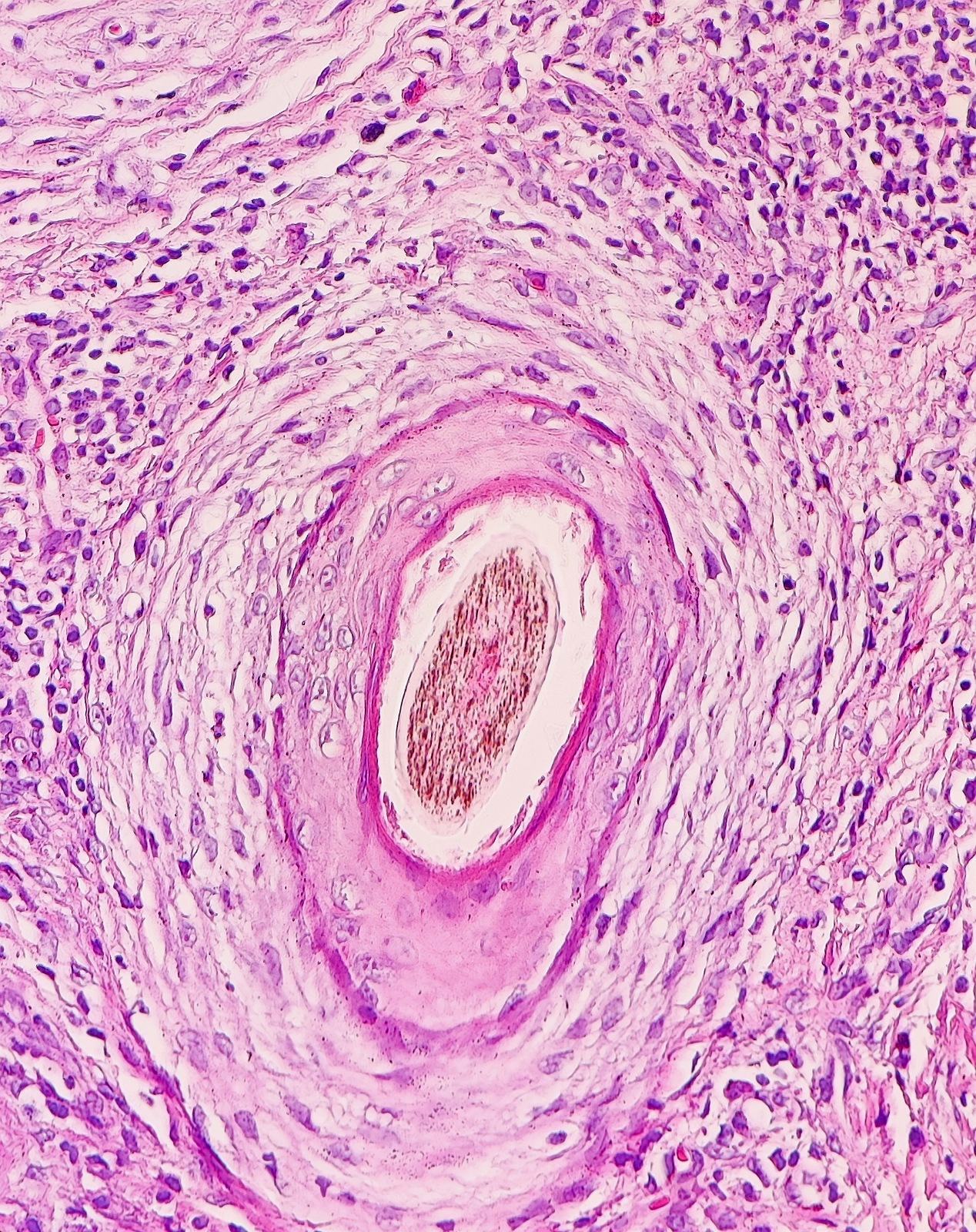 Pathology Outlines - Dissecting cellulitis