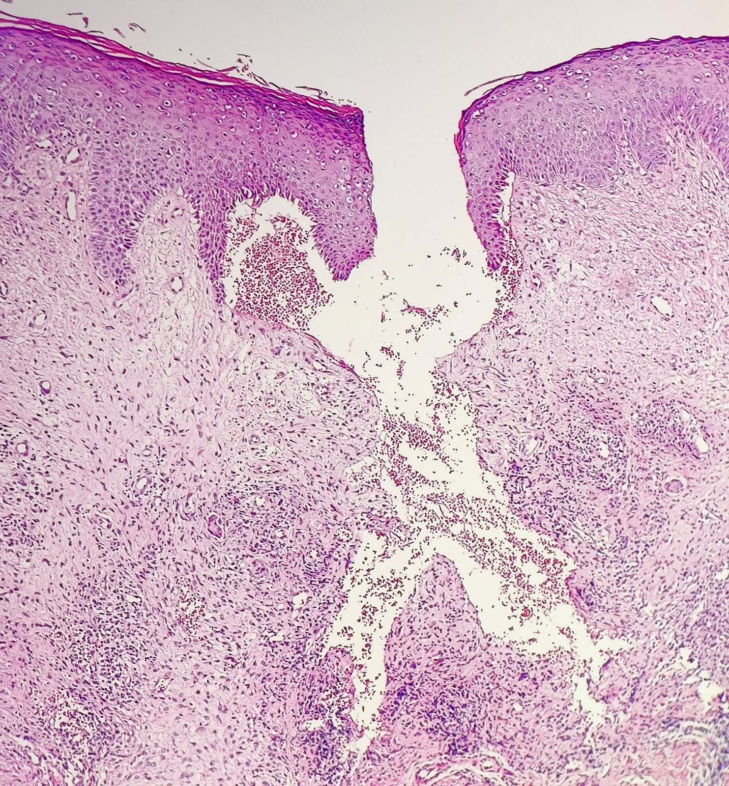 Pathology Outlines - Dissecting cellulitis
