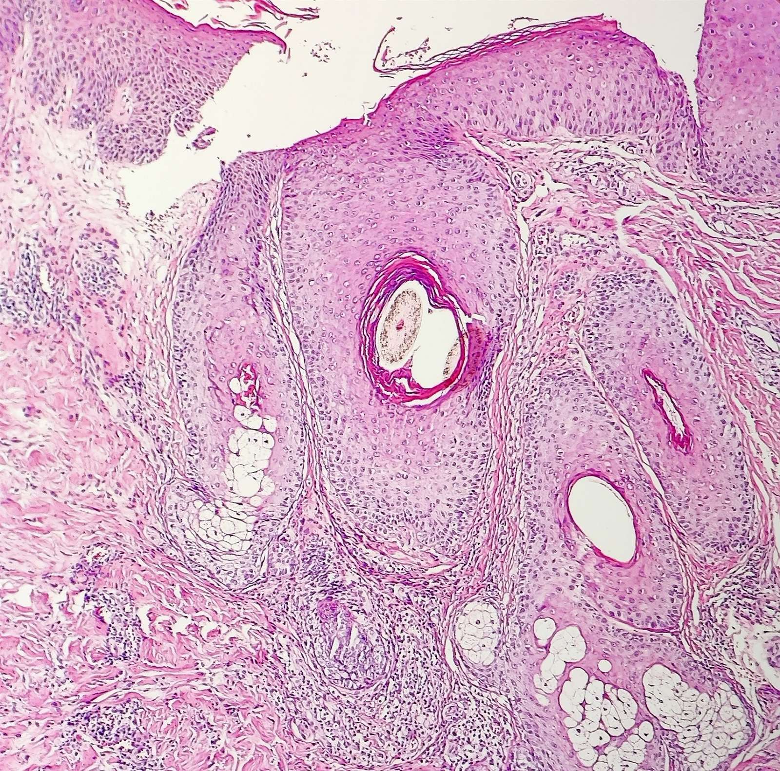 Pathology Outlines - Dissecting cellulitis