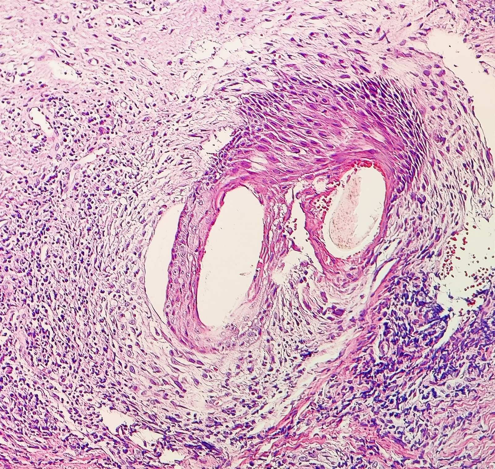 Pathology Outlines - Dissecting cellulitis