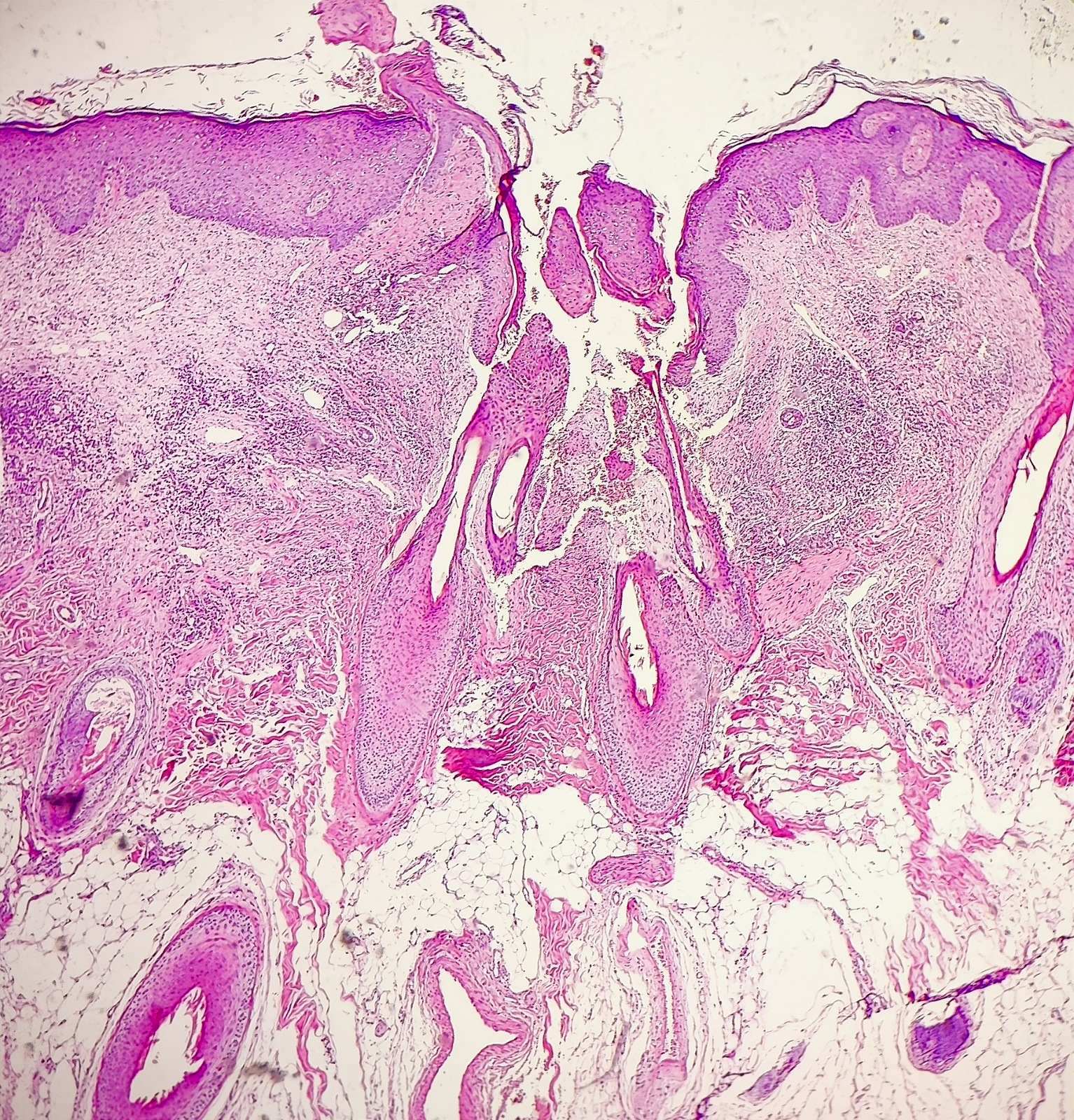 Pathology Outlines - Dissecting cellulitis