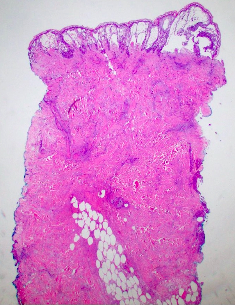 Pathology Outlines - Ecthyma gangrenosum
