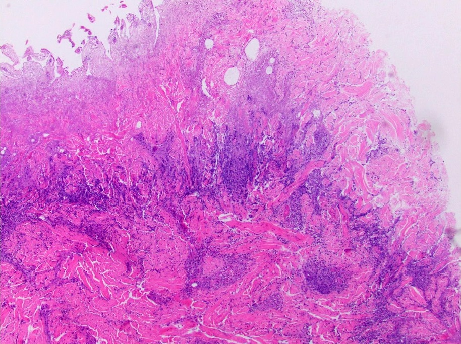 Pathology Outlines - Ecthyma gangrenosum