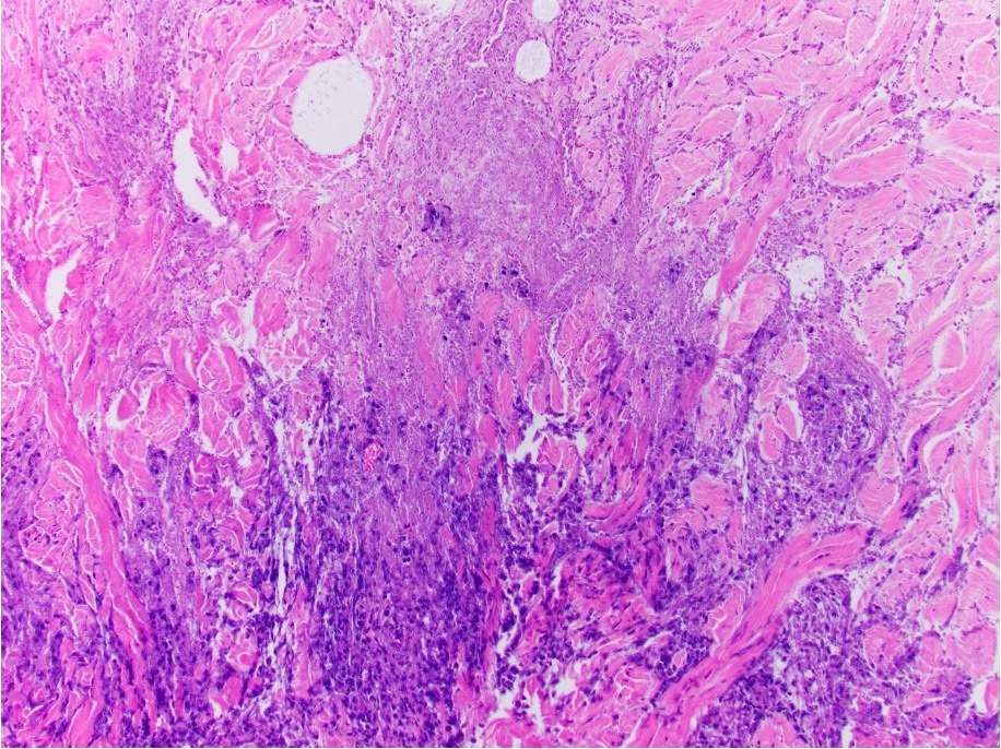 Pathology Outlines - Ecthyma gangrenosum