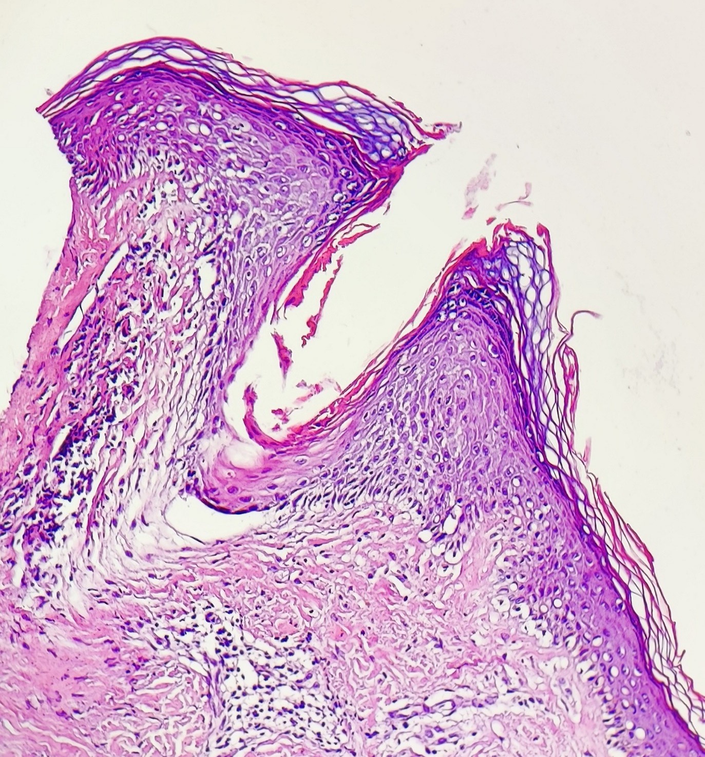 Pathology Outlines - Lichen planopilaris