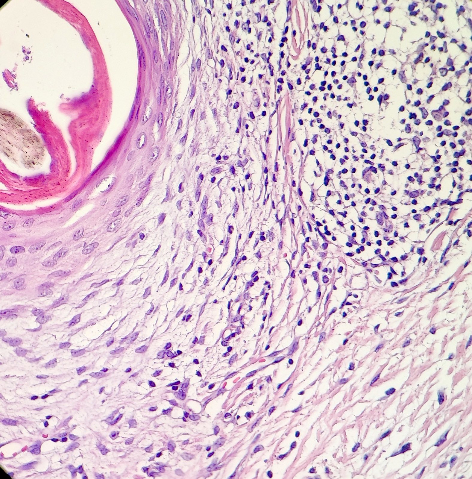 Lichen Planopilaris Histology Scarring Alopecia | Actas