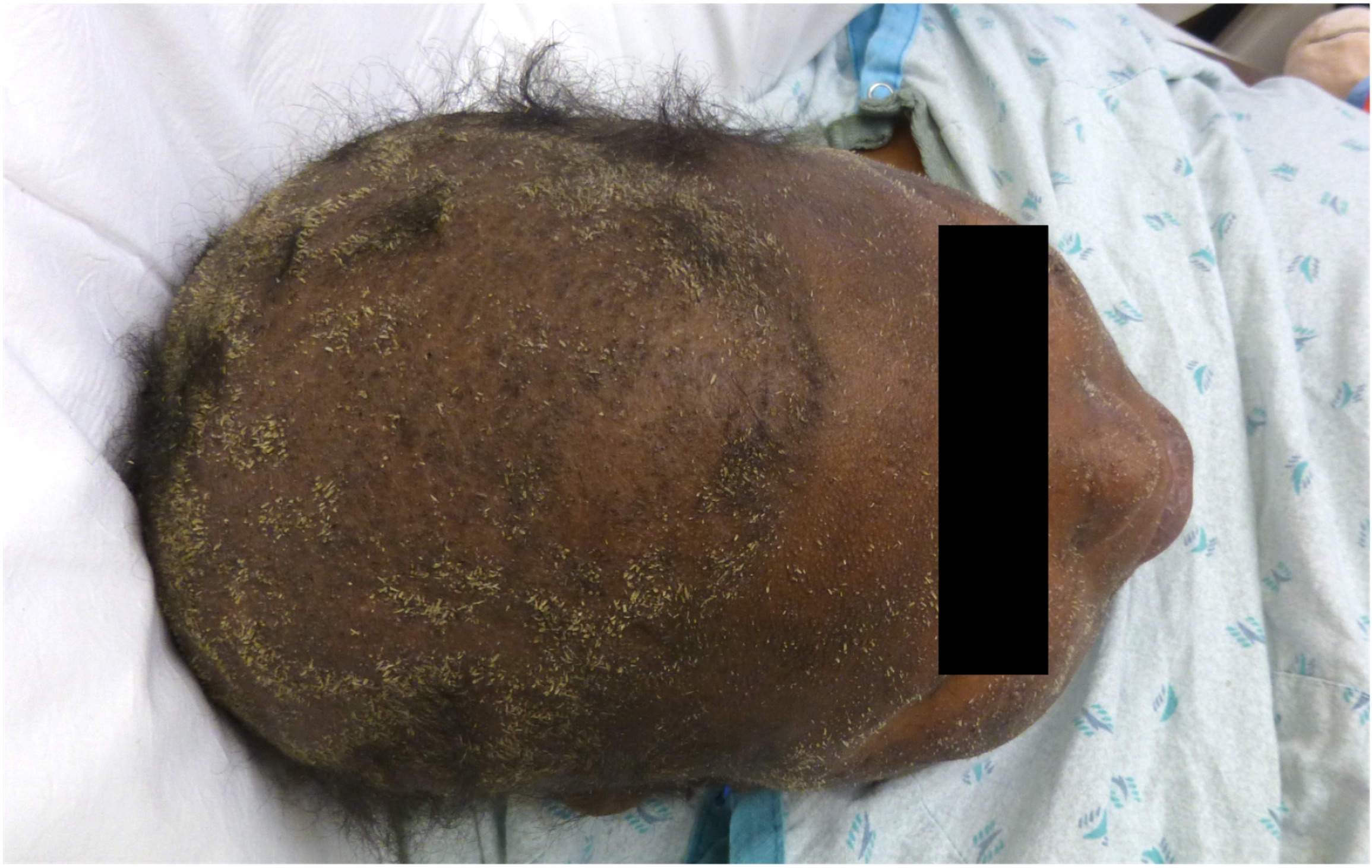 Pathology Outlines - Nutritional deficiency
