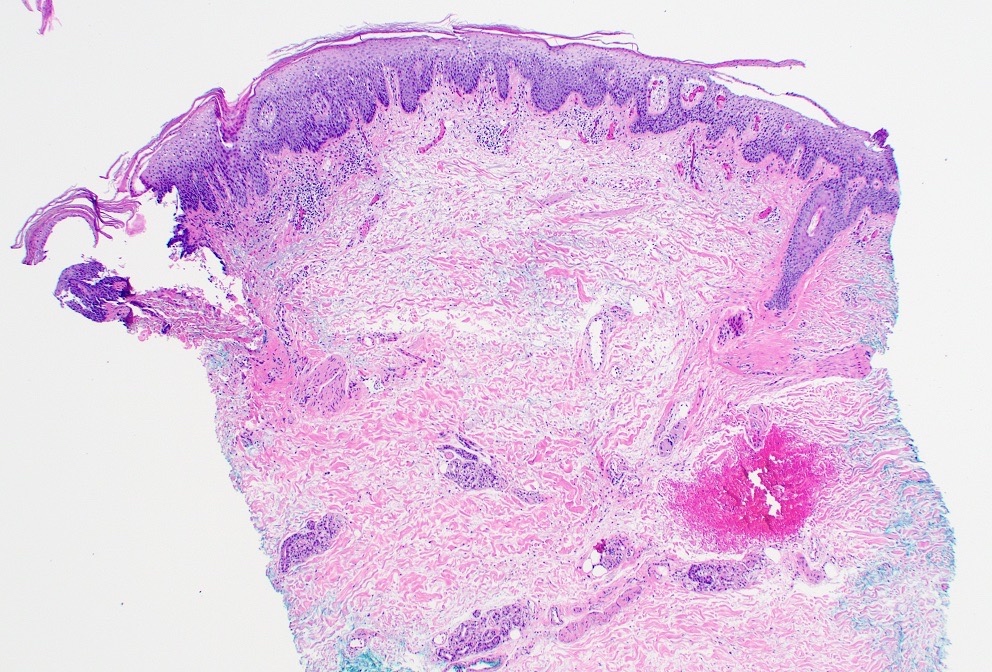 Pathology Outlines - Nutritional deficiency