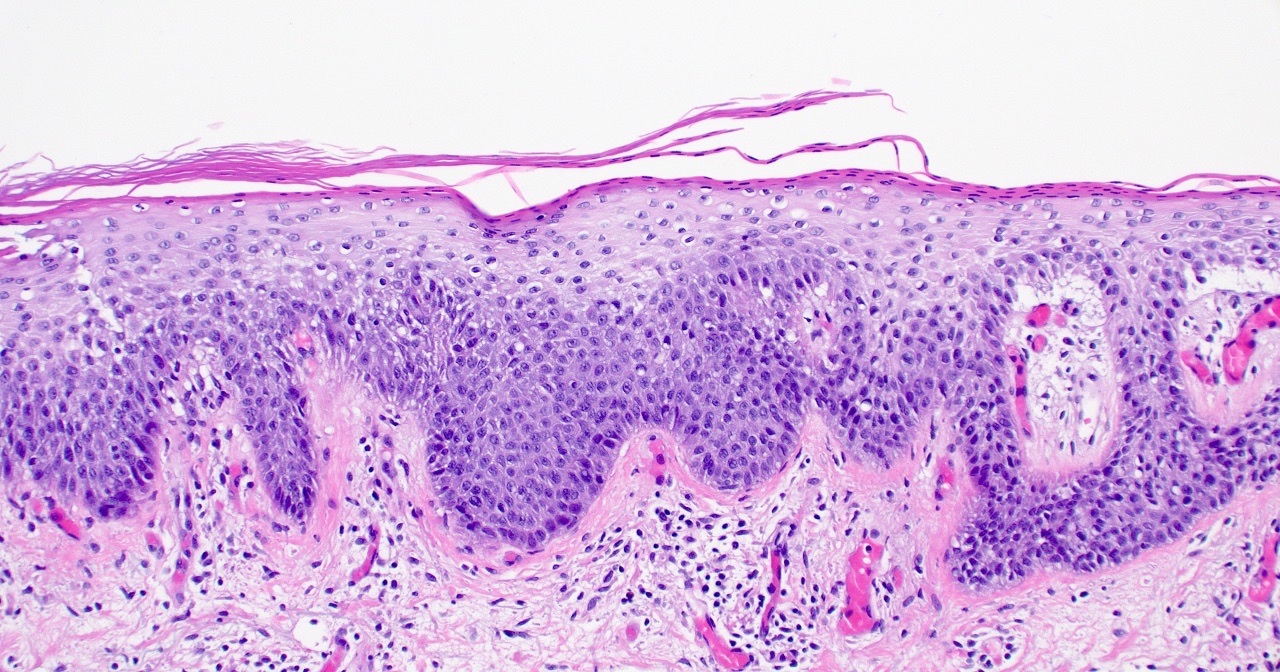 Pathology Outlines - Nutritional deficiency