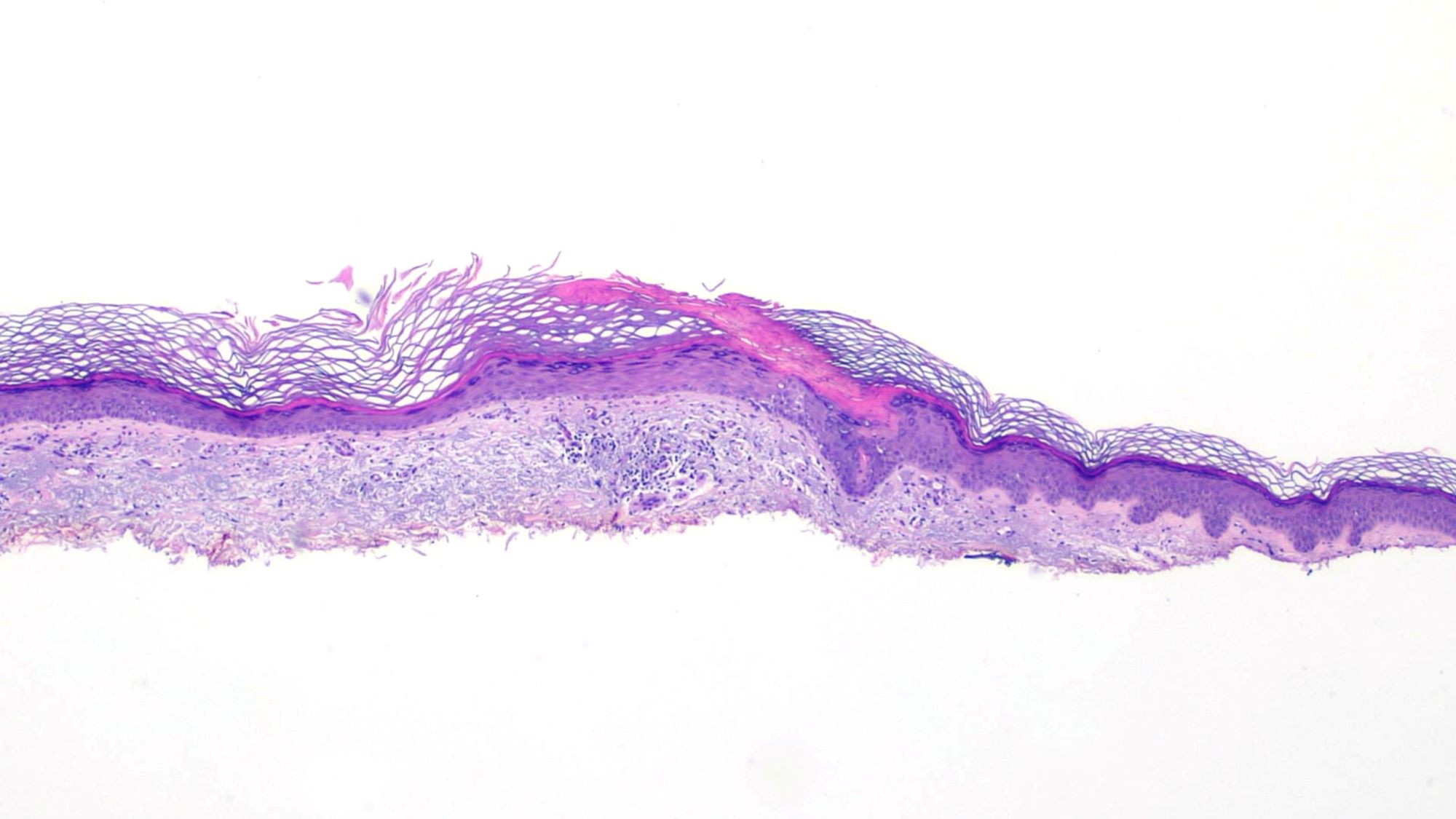 Pathology Outlines - Porokeratosis
