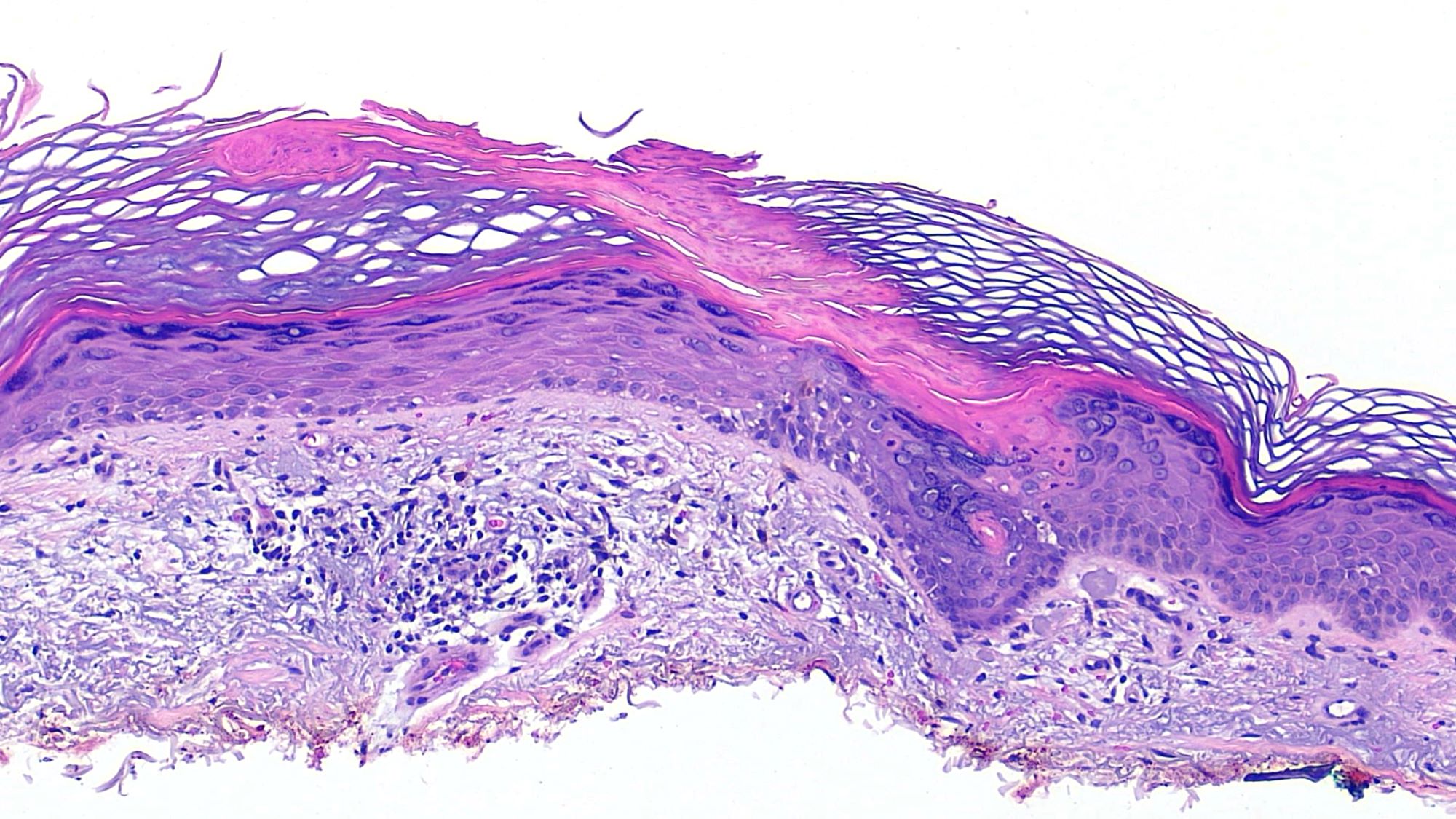 Pathology Outlines - Porokeratosis