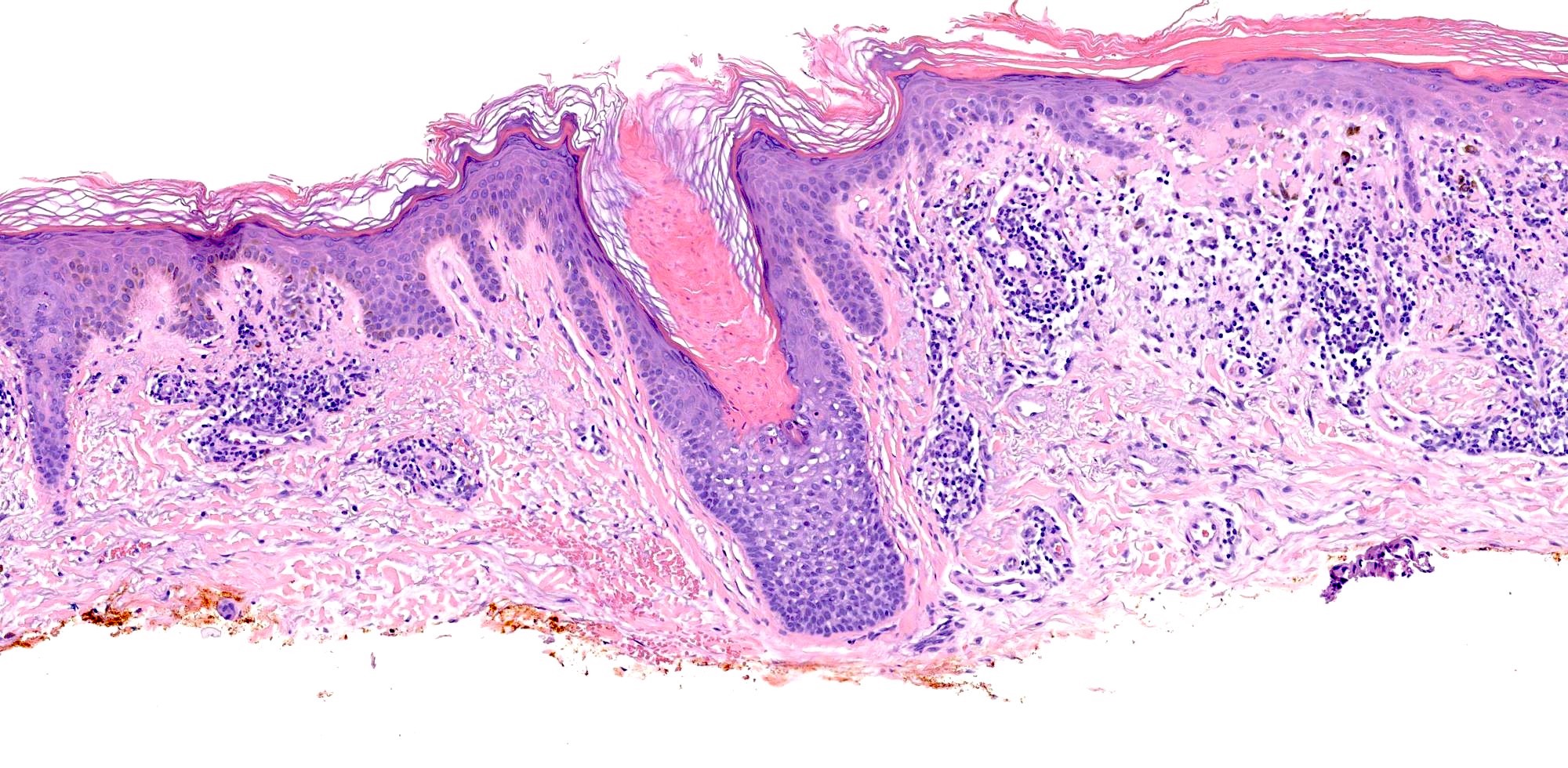 Pathology Outlines - Porokeratosis