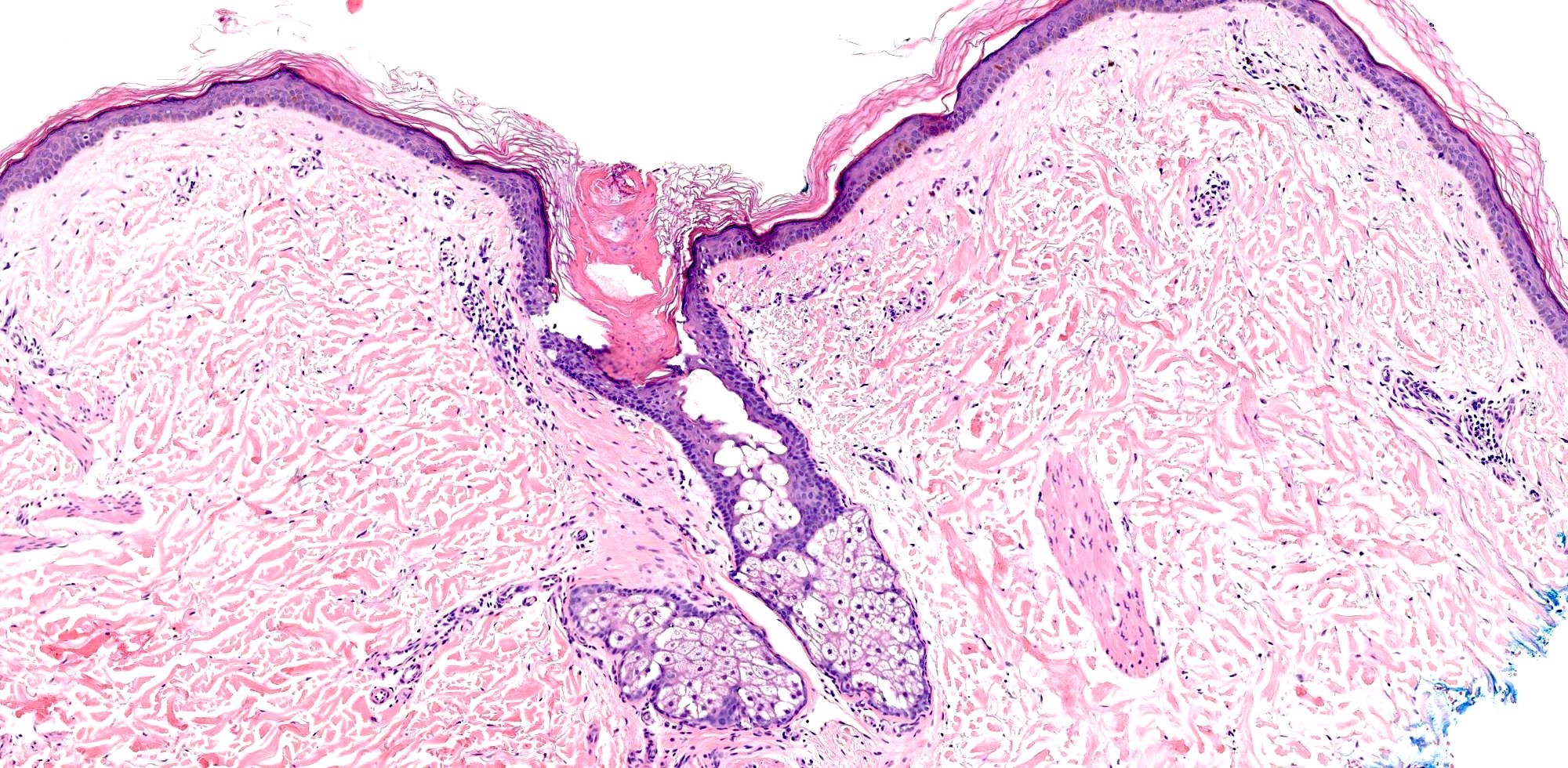 Pathology Outlines - Porokeratosis