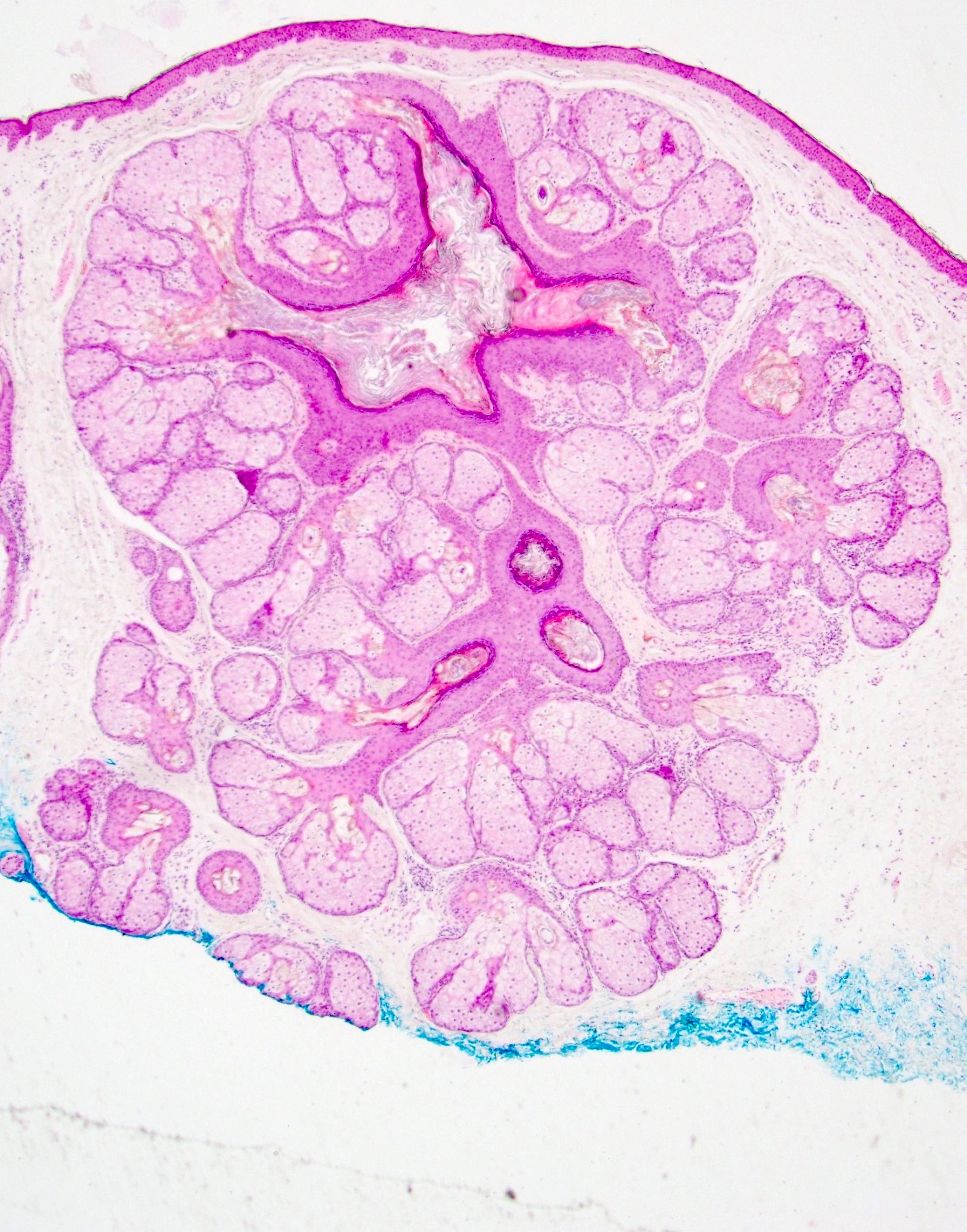 Pathology Outlines - Sebaceous hyperplasia